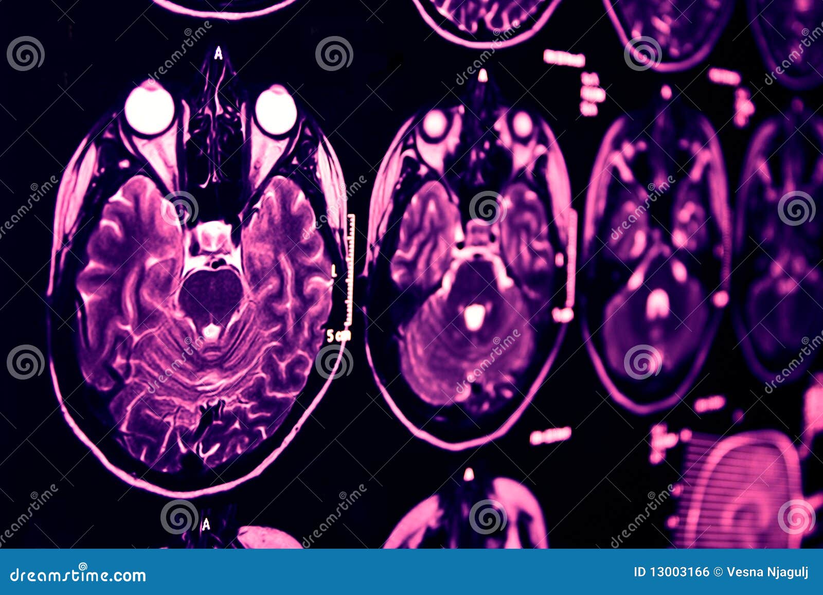 Magnetic Resonance of Brain, Blue MR Stock Photo - Image of medical ...