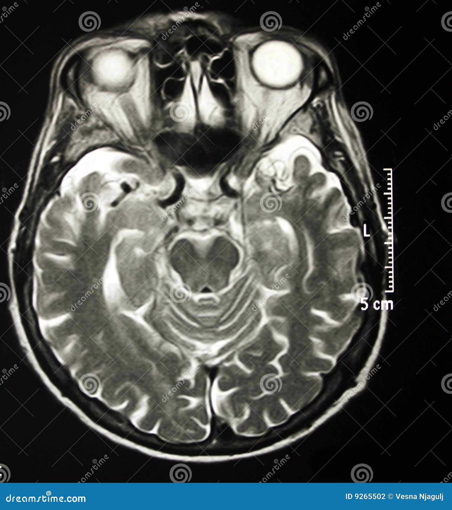 Magnetic Resonance of Brain, MR Stock Photo - Image of aneurysm ...