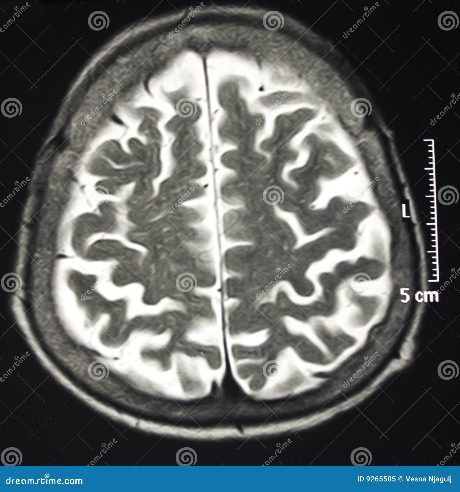 Magnetic Resonance of Brain, MR Stock Image - Image of life, artery ...