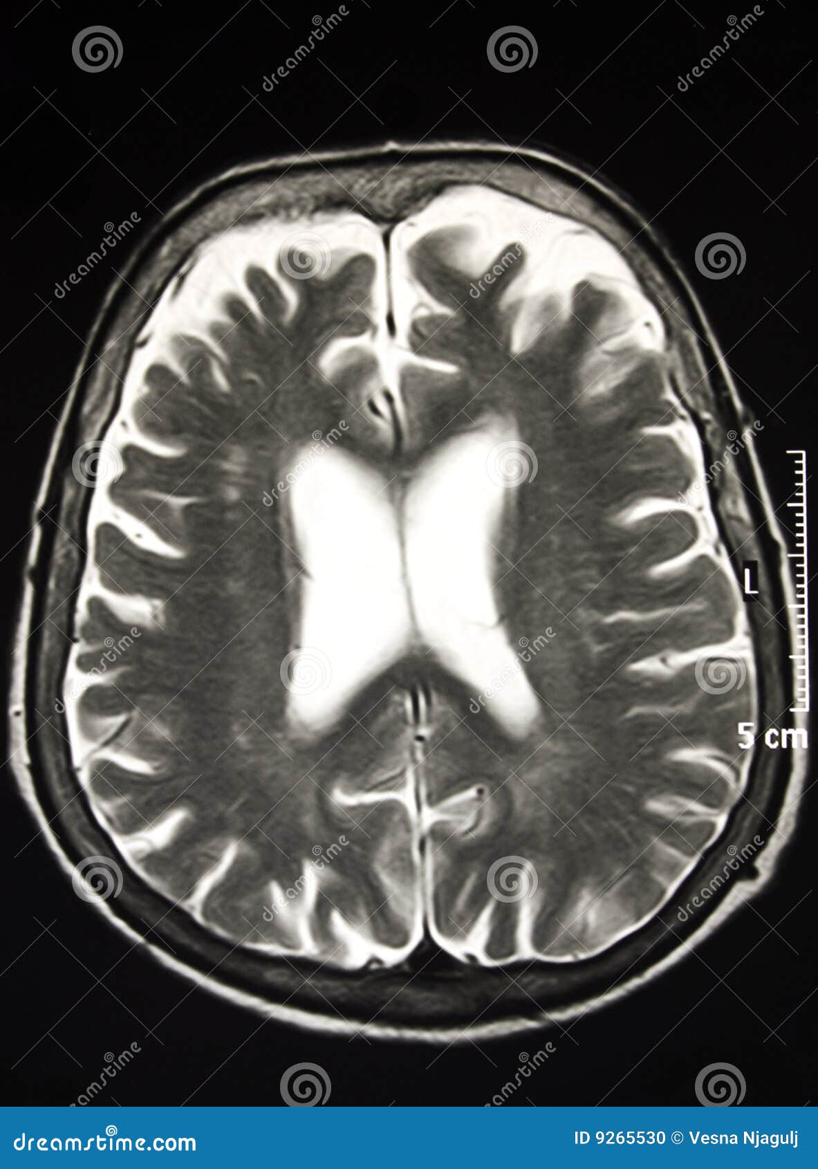 Magnetic Resonance of Brain, MR Stock Photo - Image of brain, male: 9265530