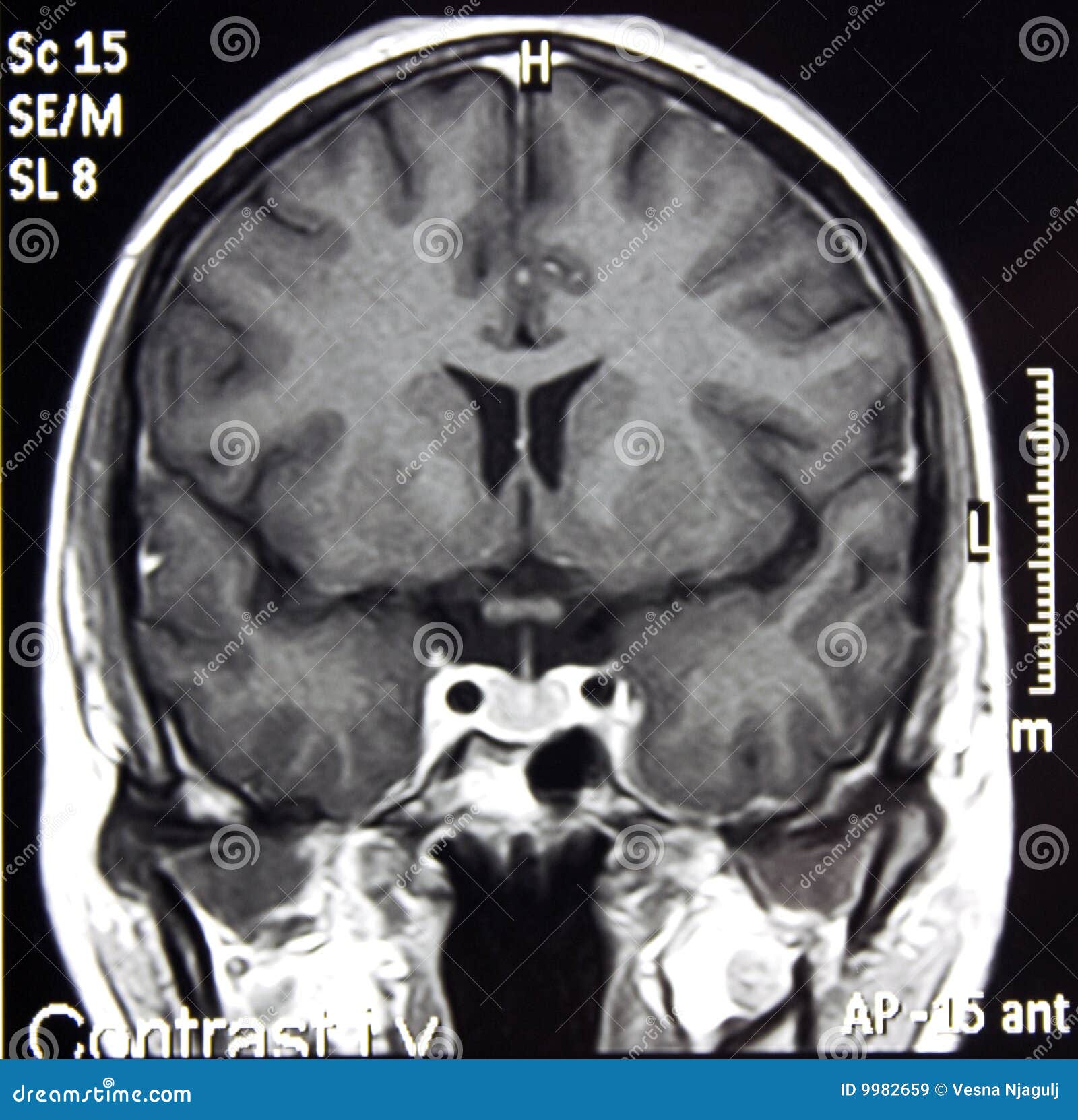 Magnetic Resonance MRI Of Right Knee, Knee Joint Effusion, Sagittal ... Magnetic Resonance MRI Of Right Knee, Knee Joint Effusion, Sagittal ...