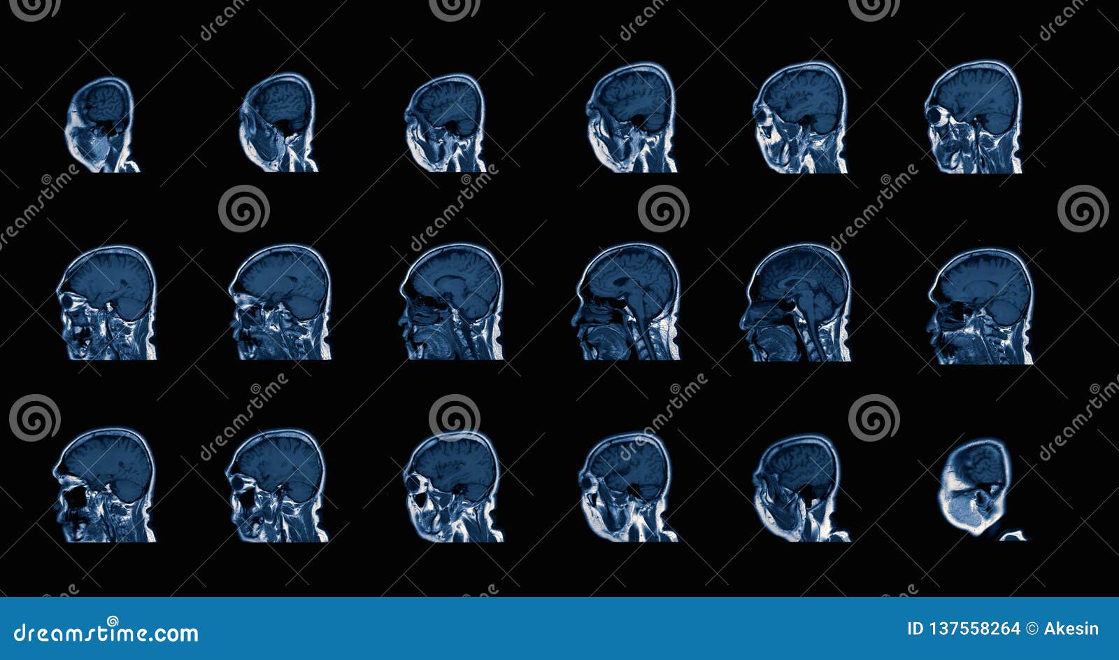 Magnetic Resonance Image MRI of the Brain Stock Photo - Image of ...