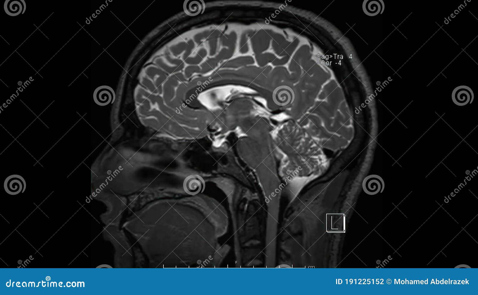 Magnetic Resonance Images Of The Brain MRI Brain Sagittal T2 Weighted ... Magnetic Resonance Images Of The Brain MRI Brain Sagittal T2 Weighted ...