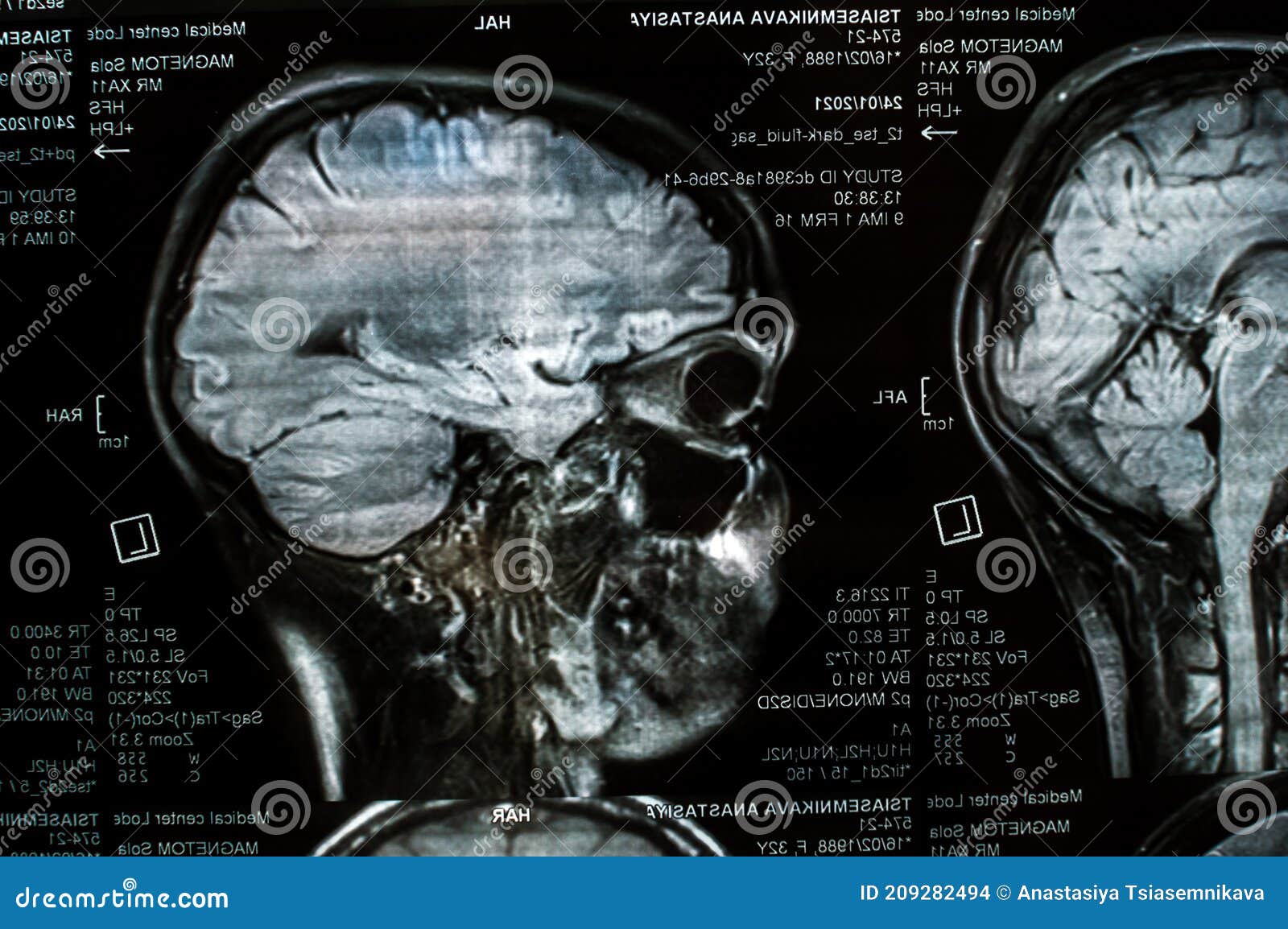 Magnetic Resonance Imaging of the Brain Close Up. Stock Photo - Image ...