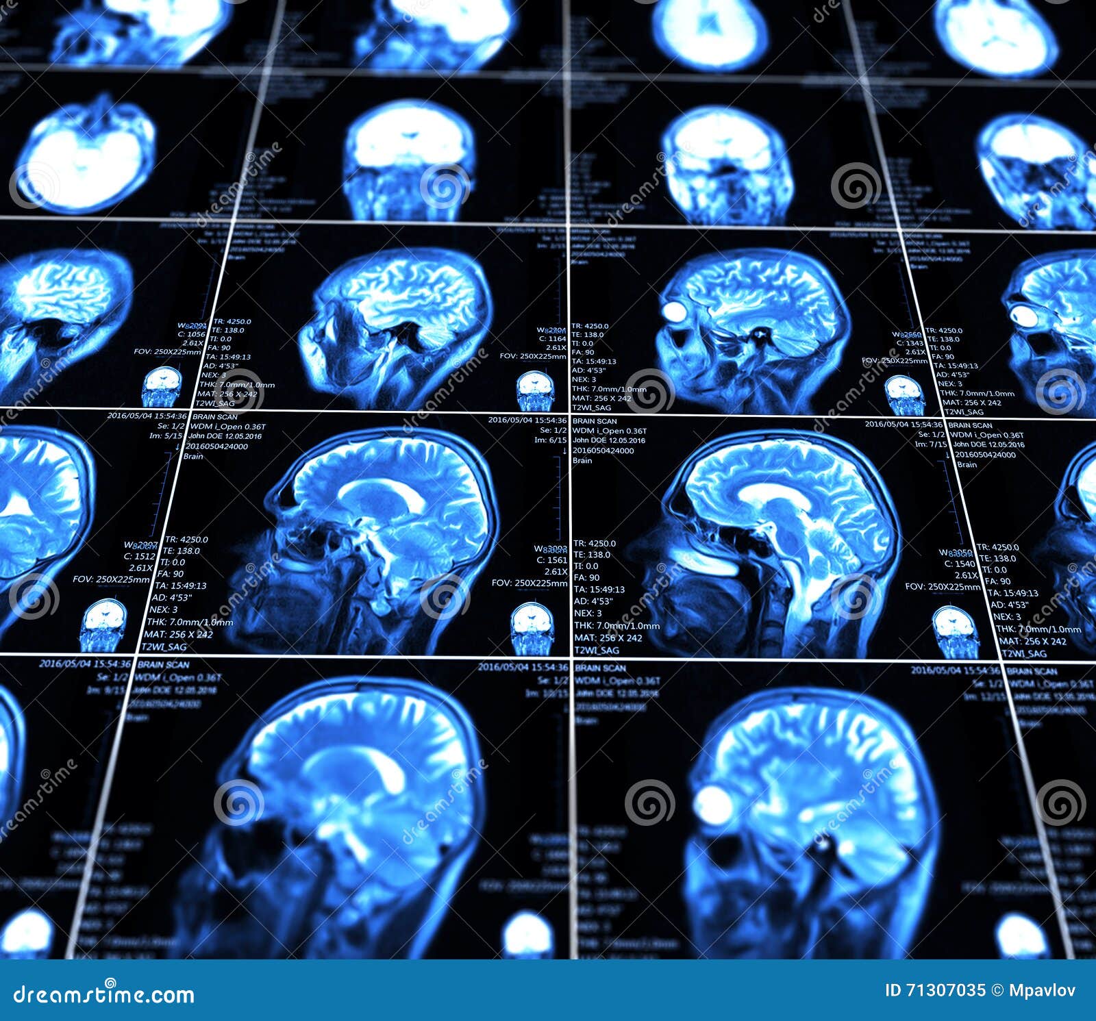 Magnetic Resonance Imaging of the Brain Stock Image - Image of magnetic ...