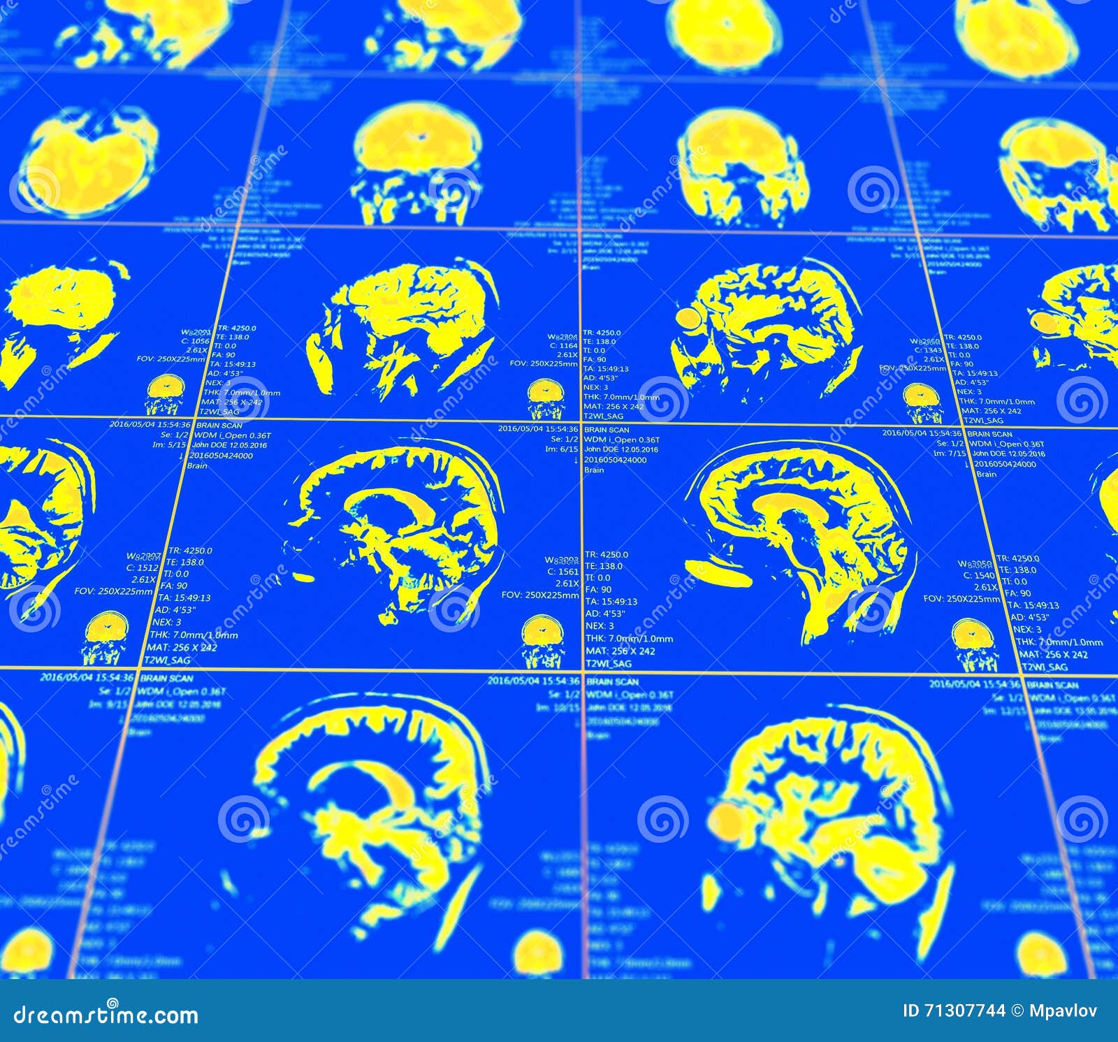 Magnetic Resonance Imaging of the Brain Stock Illustration ...