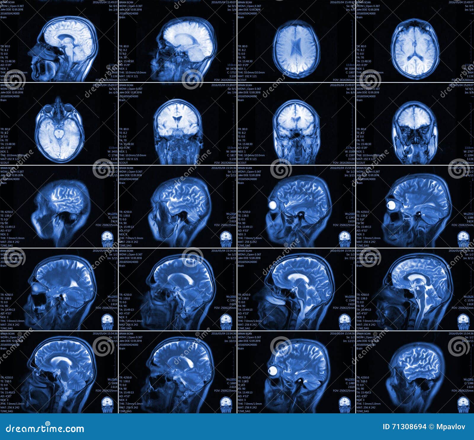 Magnetic Resonance Imaging of the Brain Stock Photo - Image of medicine ...