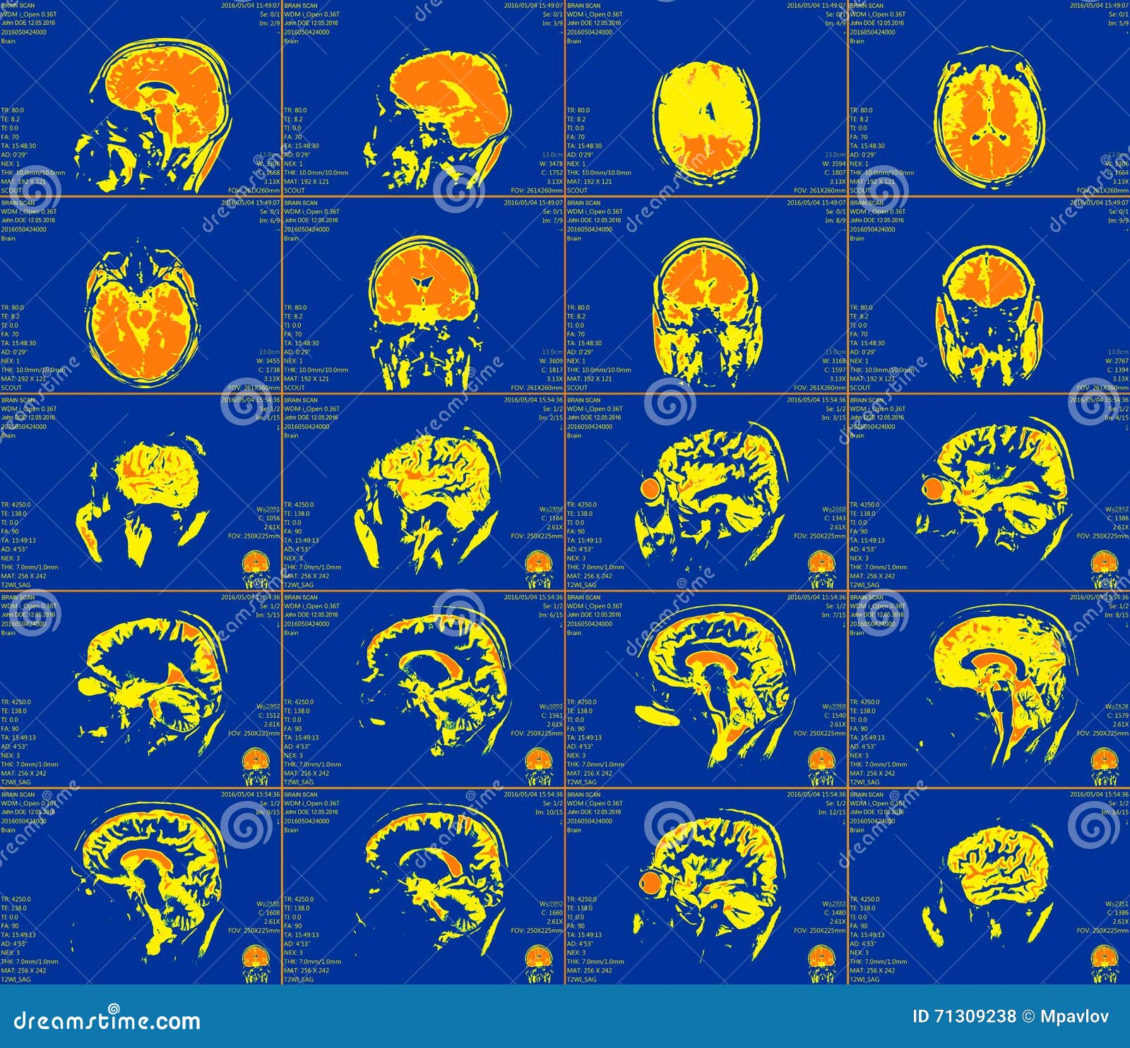Magnetic Resonance Imaging of the Brain Stock Illustration ...