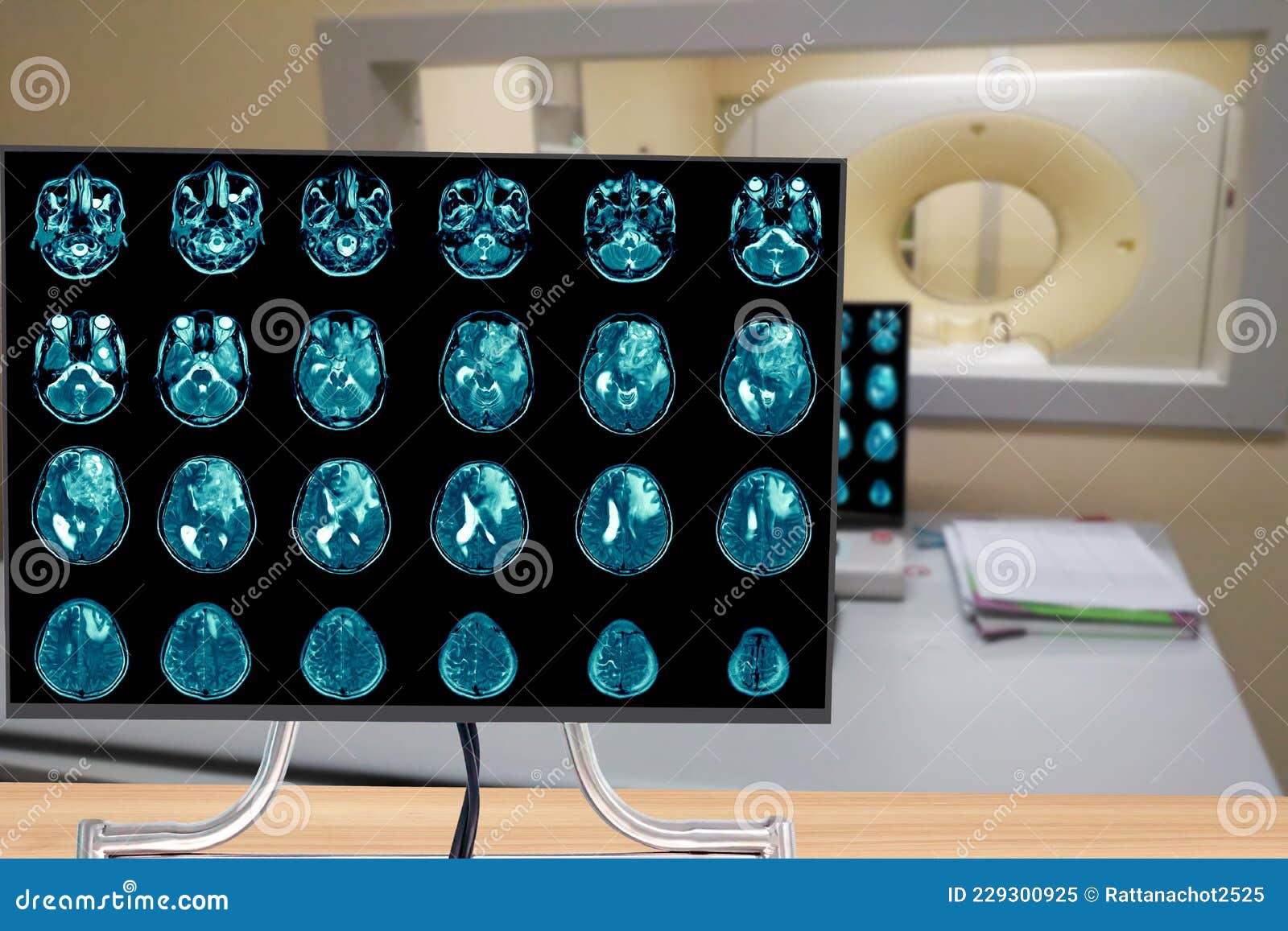 Magnetic Resonance Imaging Finding 5 Cm Isodense Mass With Ill Defined