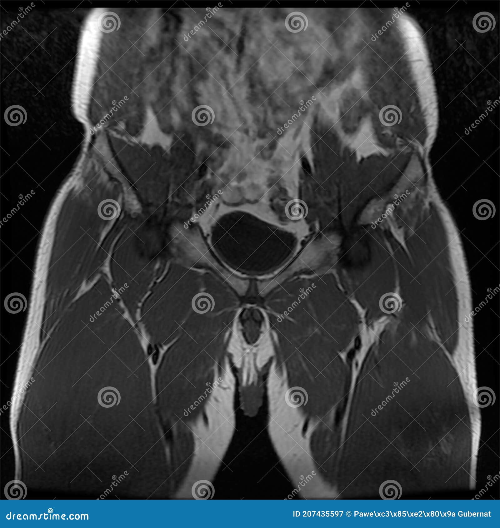 Magnetic Resonance Imaging of the Male Hip. Visible Changes in ...
