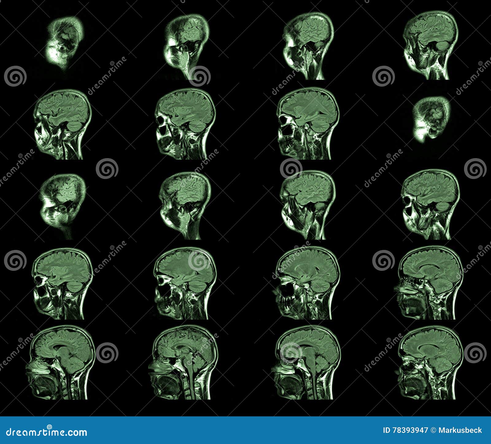 Magnetic Resonance Imaging, MRI MRT Head Stock Image - Image of ...