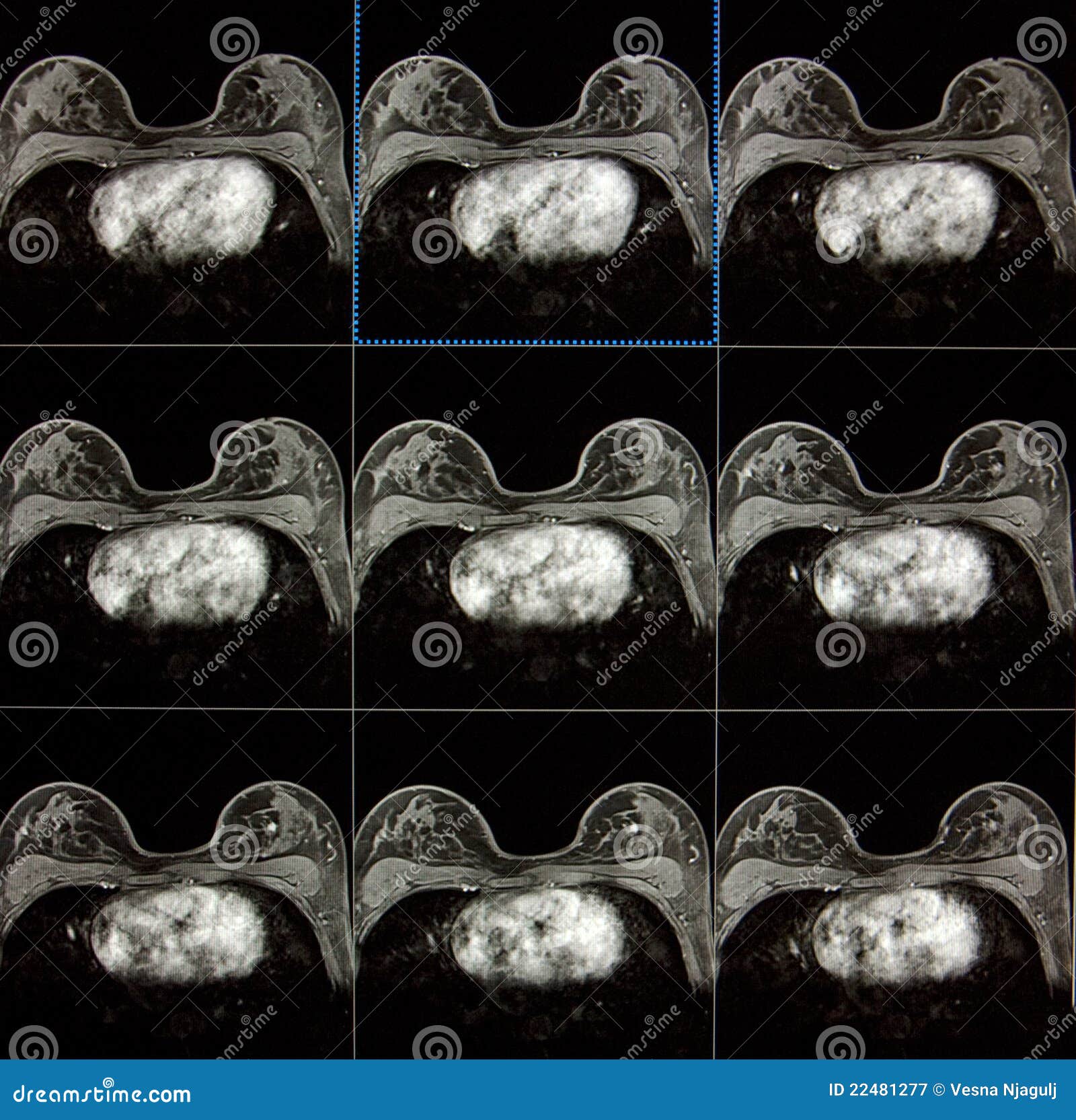 Magnetic Resonance Imaging Van Borst (MRI) Stock Afbeelding - Image of ...