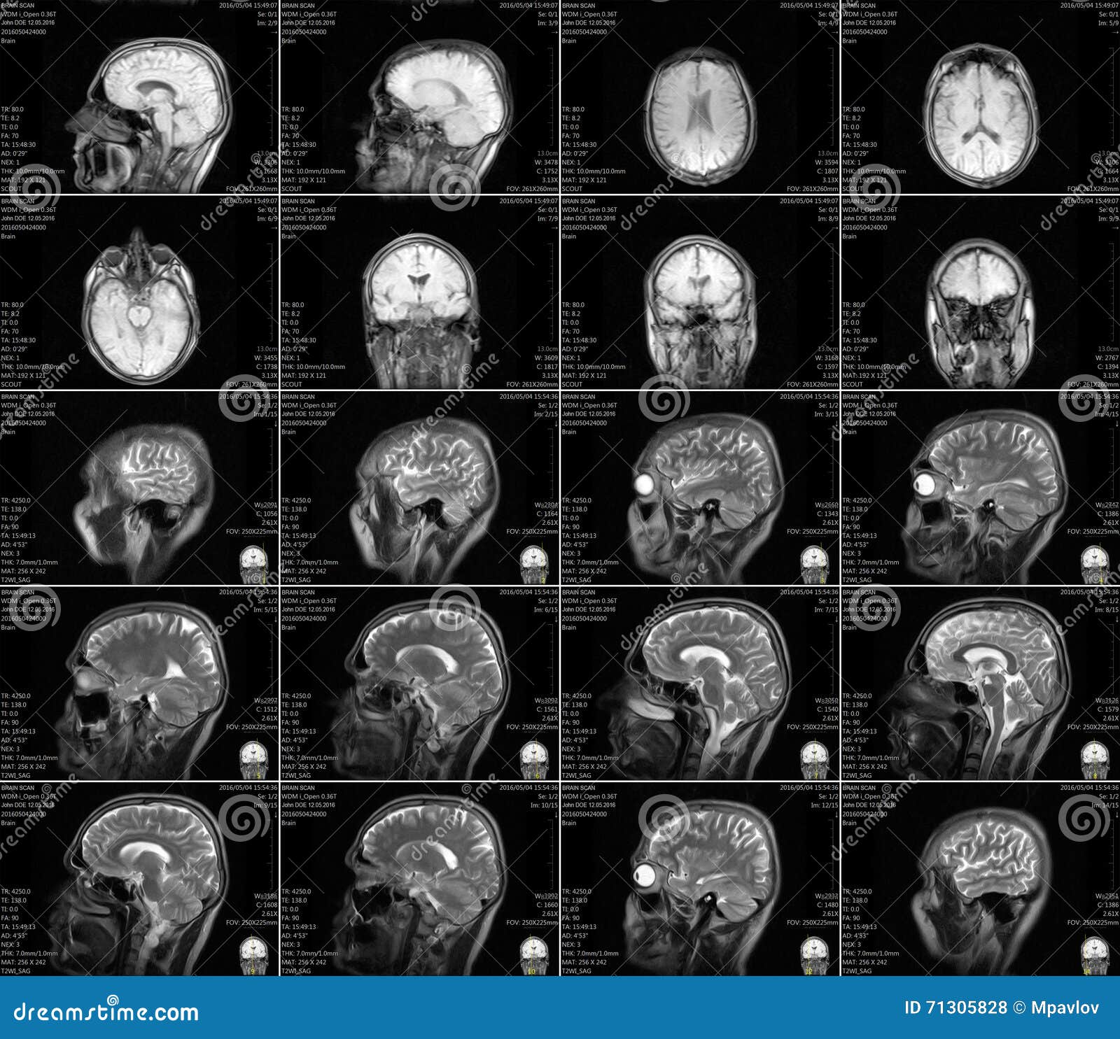 Magnetic Resonance Imaging Van De Hersenen Stock Foto - Image of ...