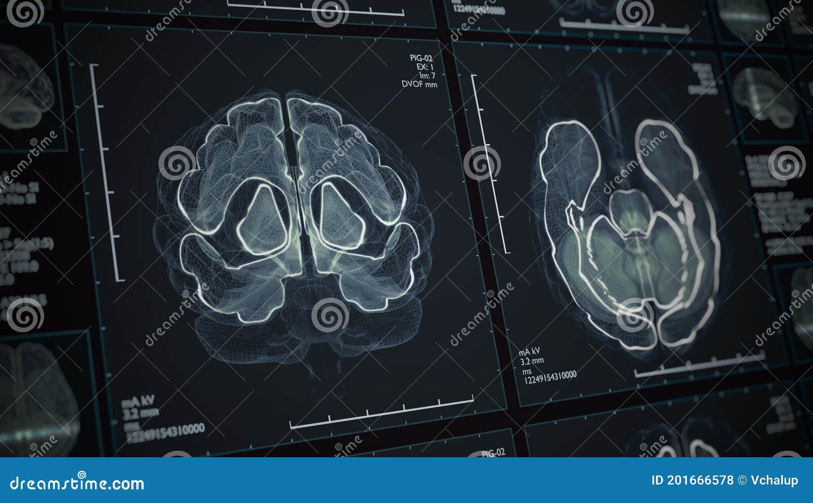 Magnetic Resonance MRI or CT Scan of Brain. 3D Rendered Illustration ...