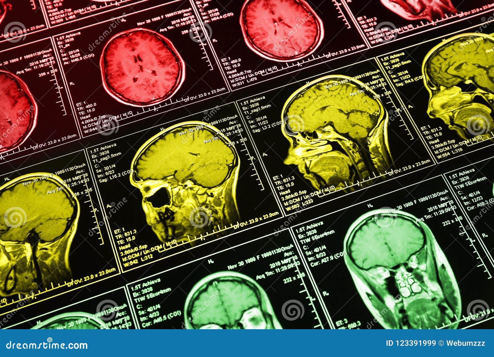 Magnetic Resonance Scan of the Brain. MRI Head Scan Stock Image - Image ...