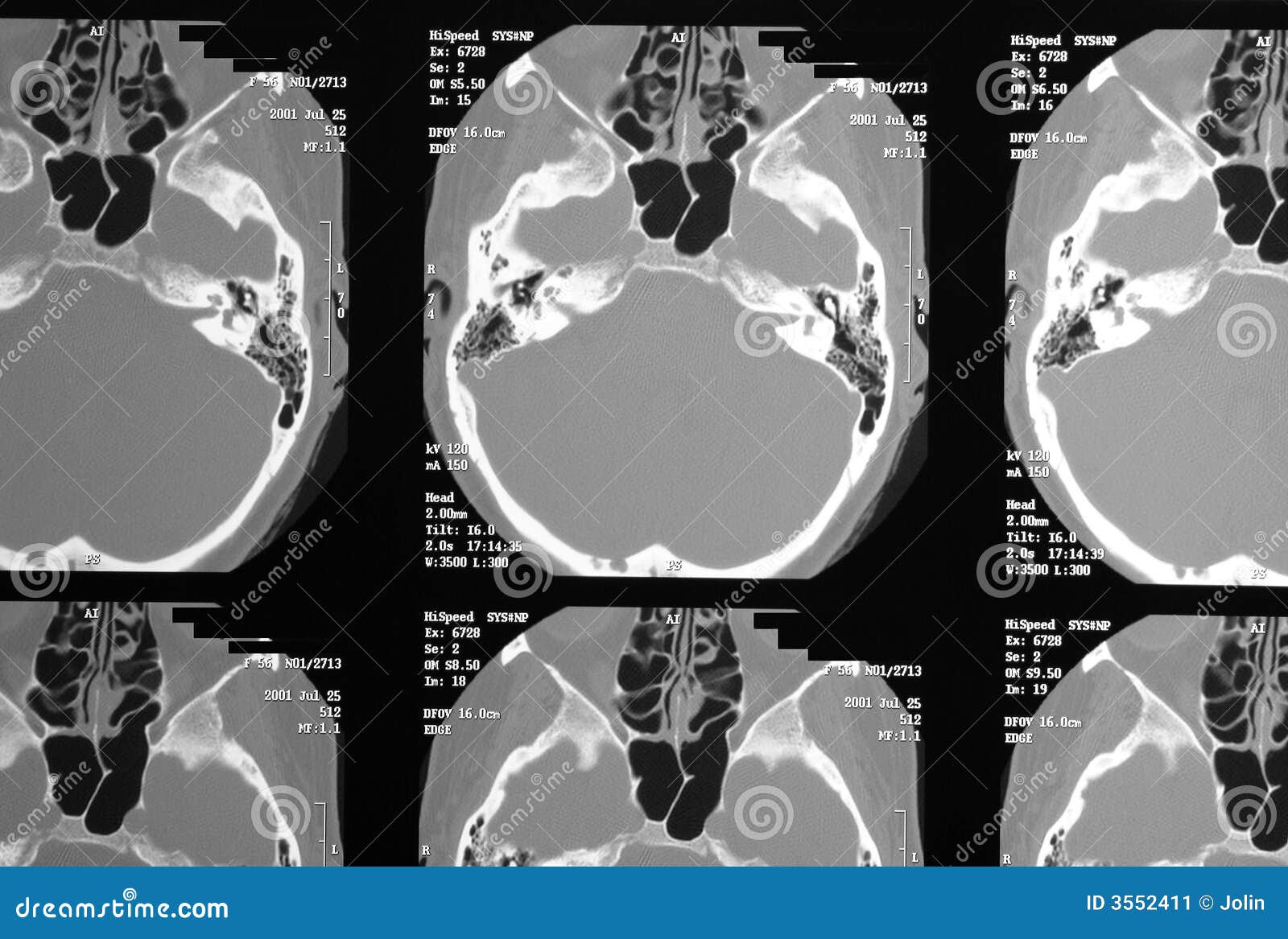 Magnetische Resonantie Van Schedel Stock Afbeelding - Image of aftasten ...