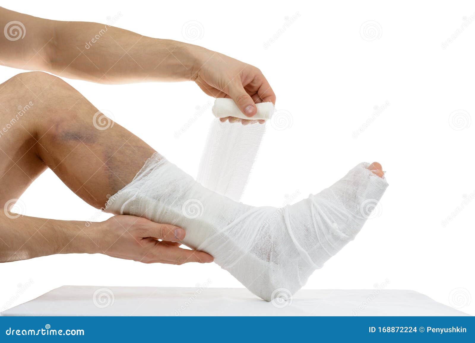 Magullado pie foto de archivo. Imagen de blanco, fractura - 168872224