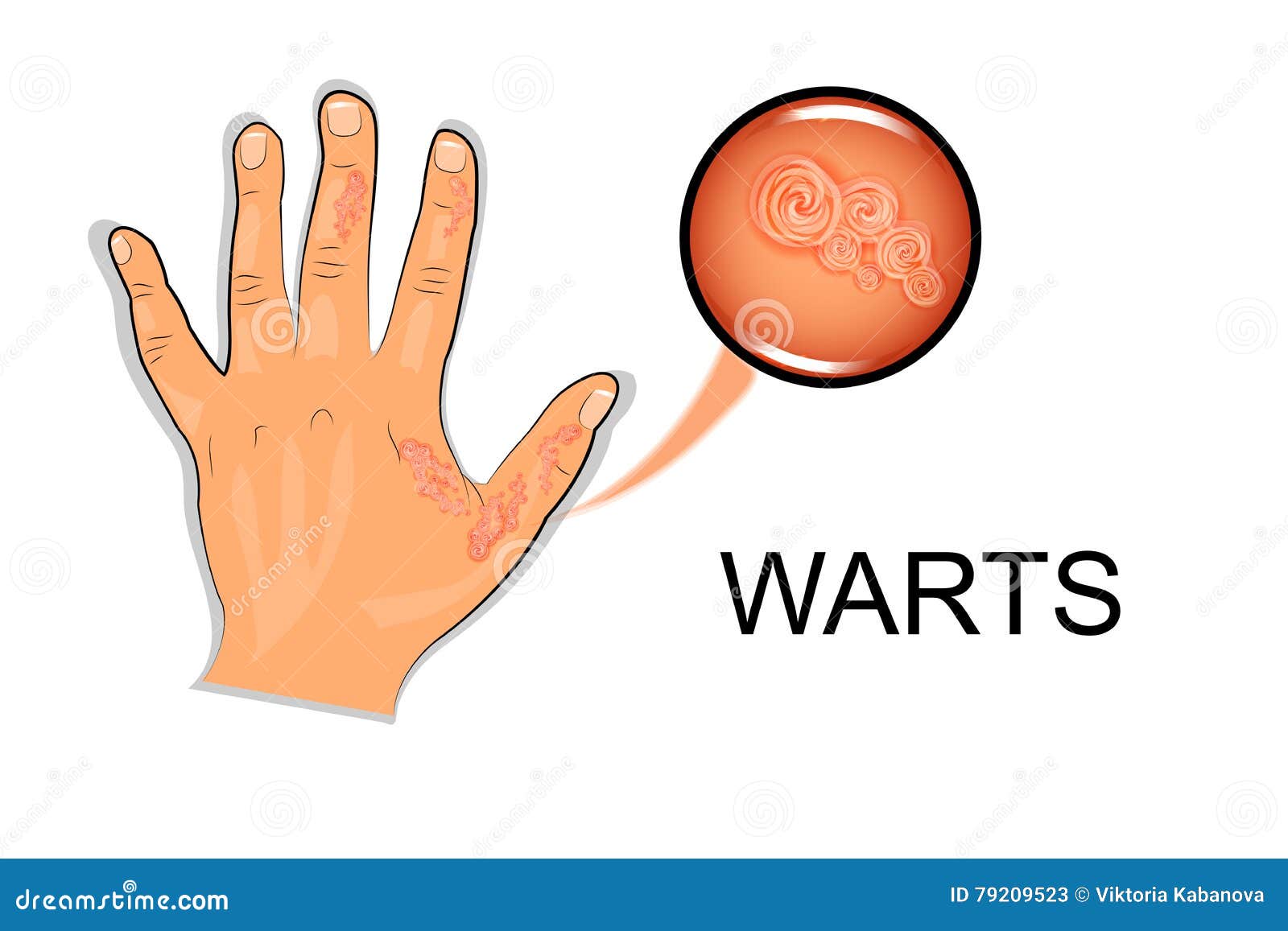 Main Affectée Par La Verrue Illustration de Vecteur - Illustration du ...