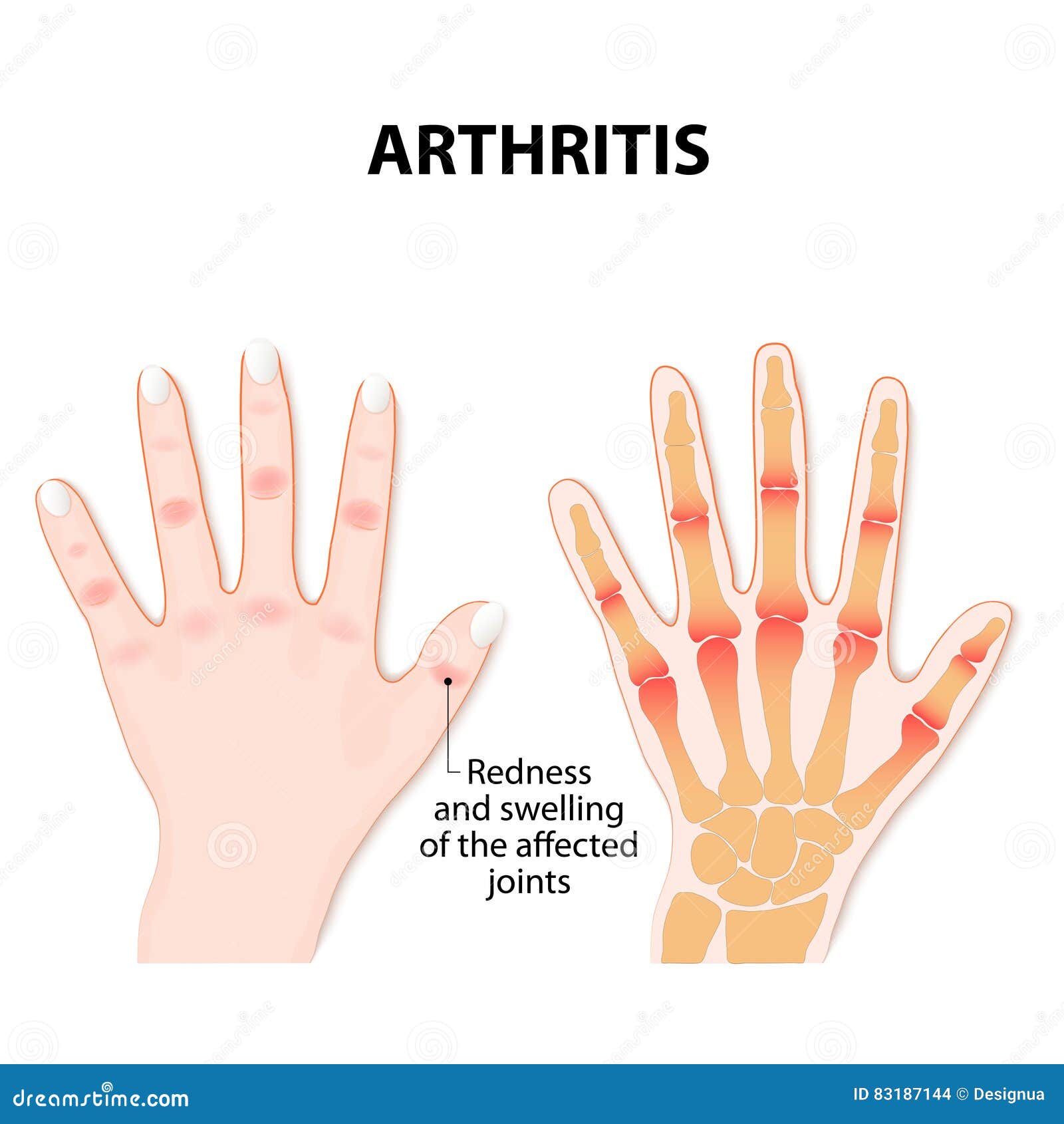 Main avec l'arthrite illustration de vecteur. Illustration du commun ...
