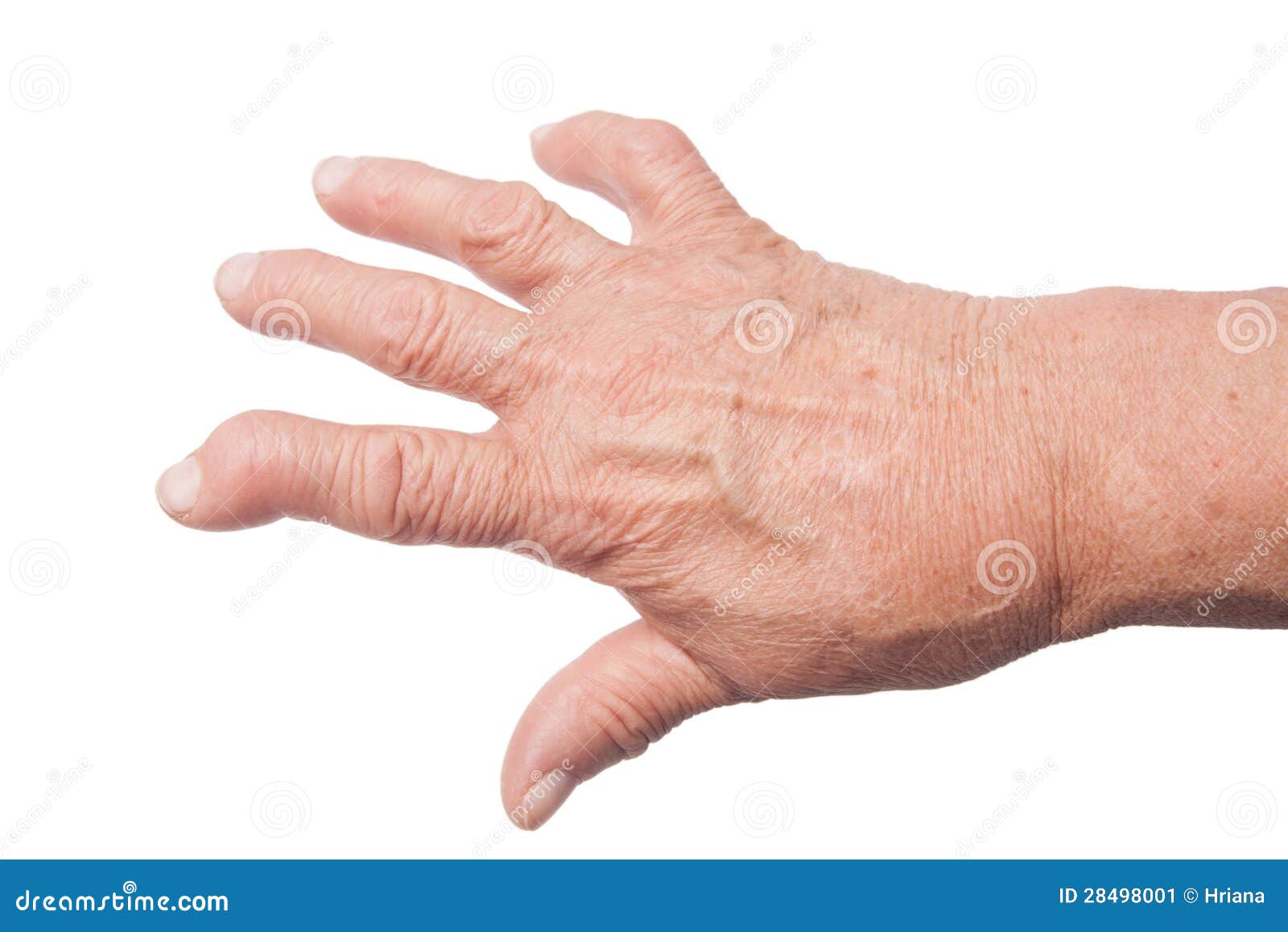 Main Avec Le Rhumatisme Articulaire Image stock - Image du rhumatisme ...