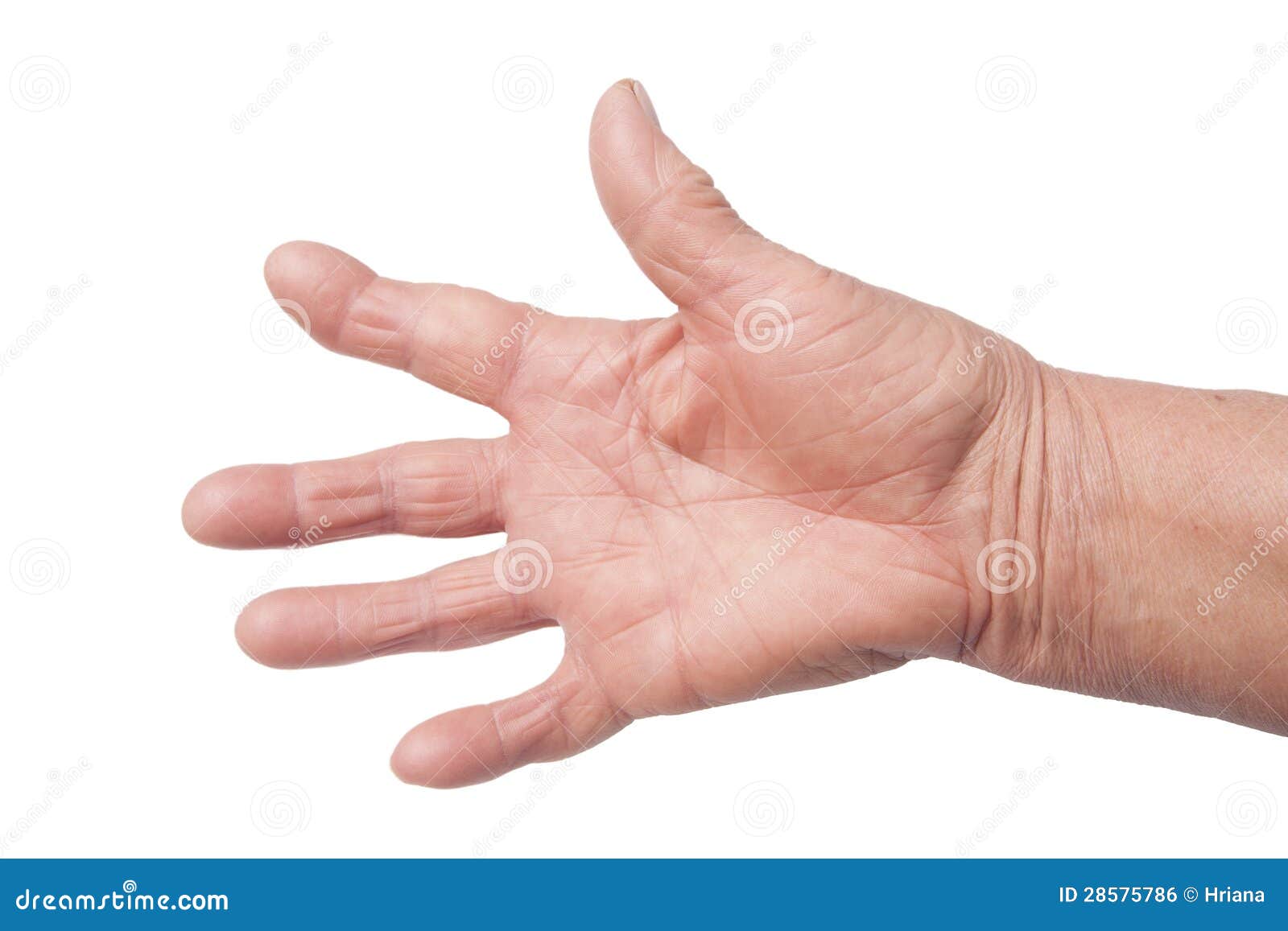 Main Avec Le Rhumatisme Articulaire Photo stock - Image du déformé ...