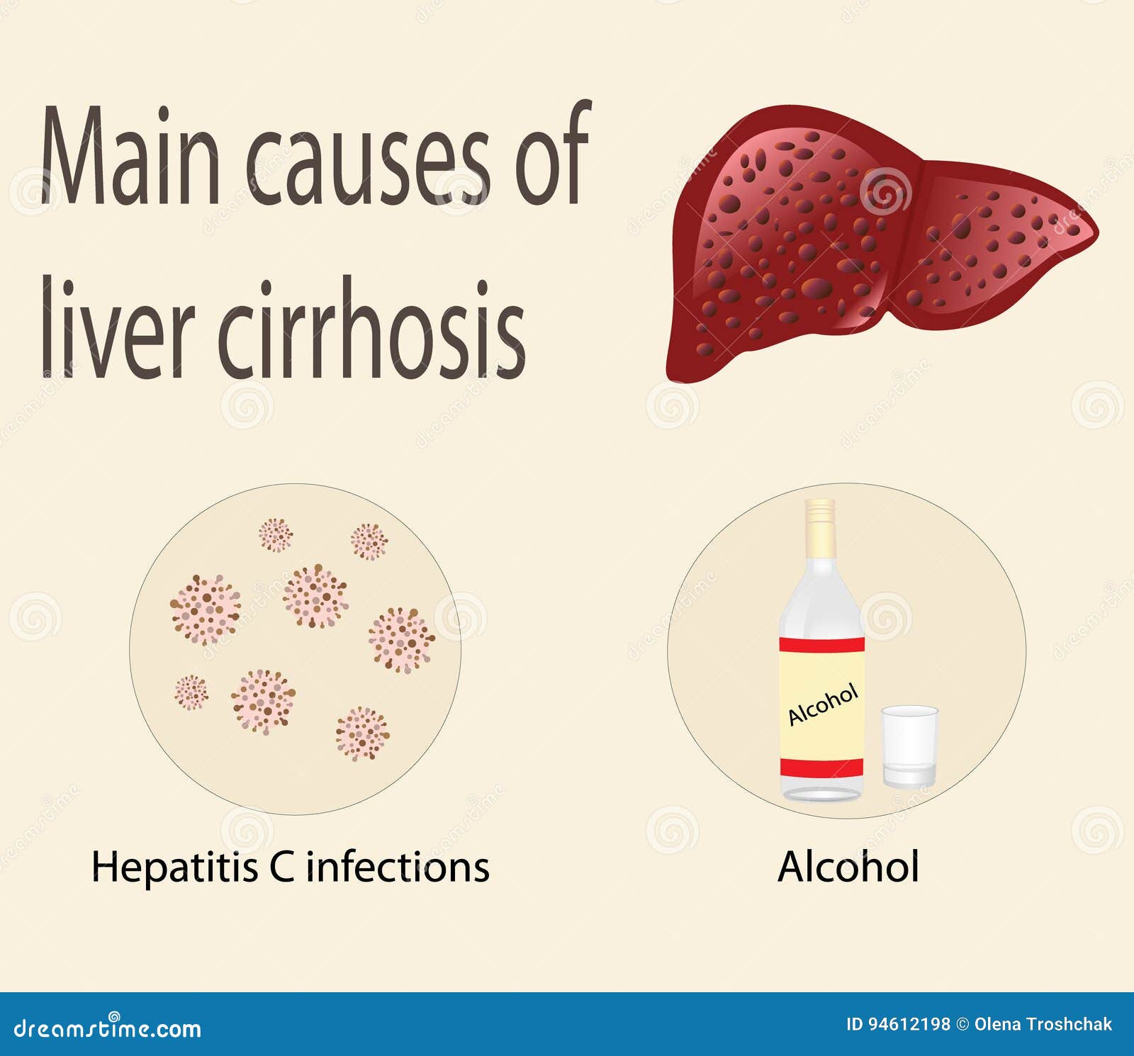 Main Causes of Liver Cirrhosis Stock Vector - Illustration of hepatitis ...