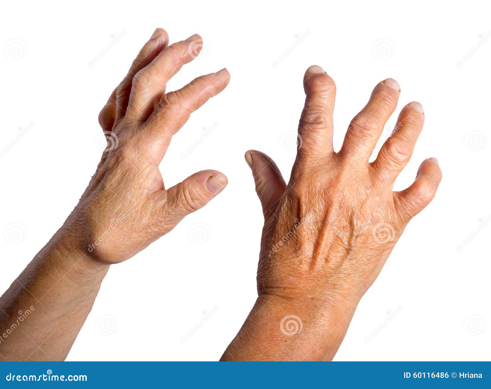 Main Déformée Du Rhumatisme Articulaire Photo stock - Image du ...