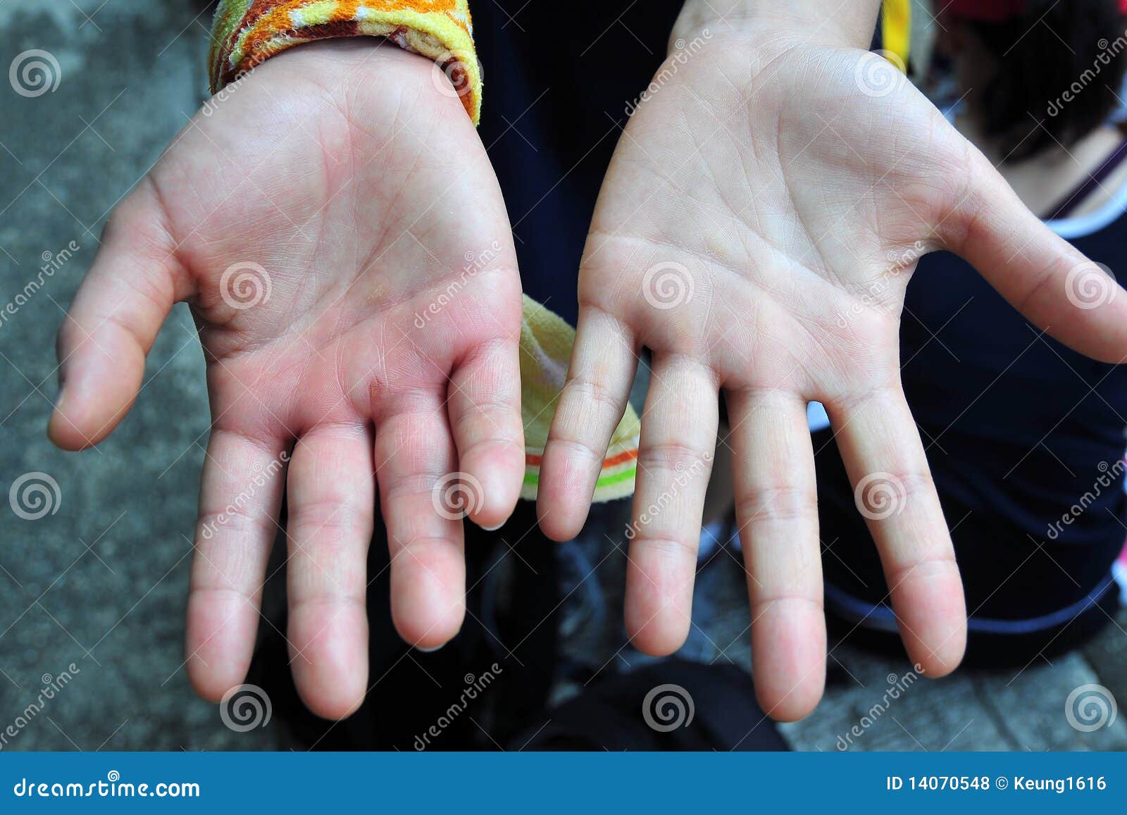 Main de gonflement photo stock. Image du mordu, empoisonnement - 14070548