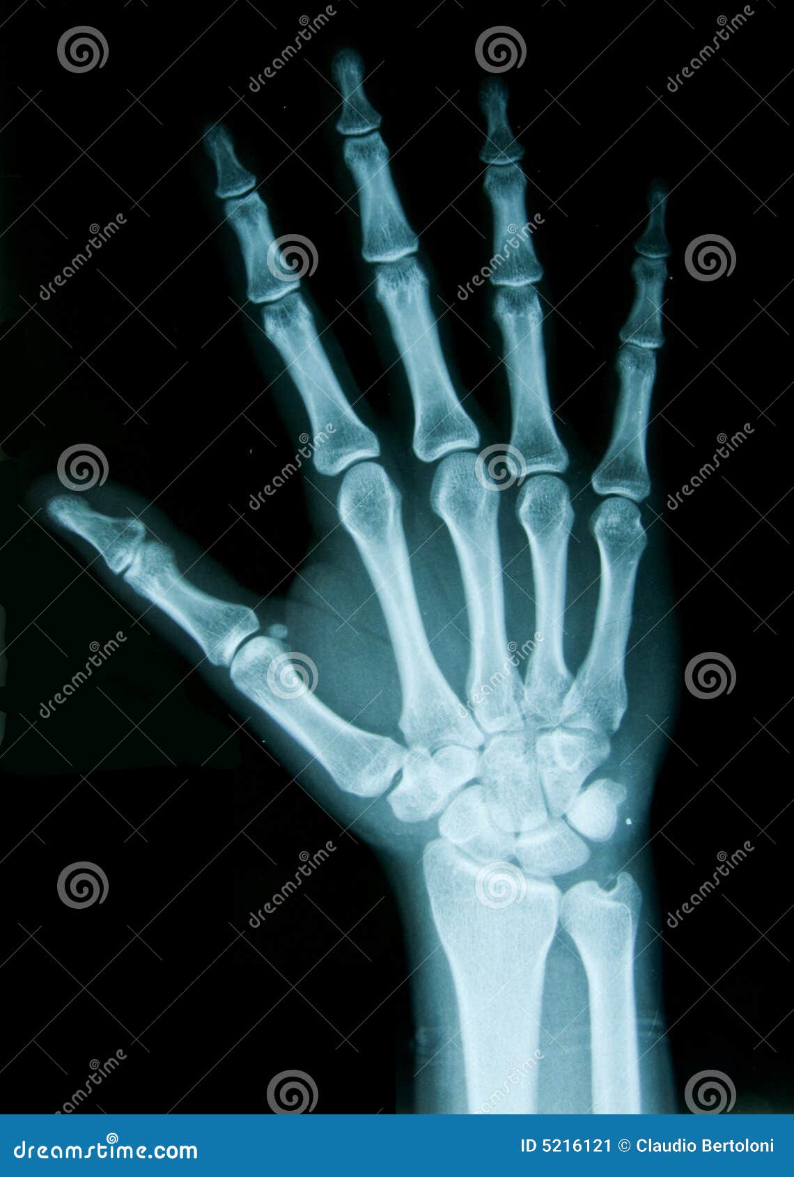 Main de rayon X image stock. Image du doigt, rayon, patte - 5216121