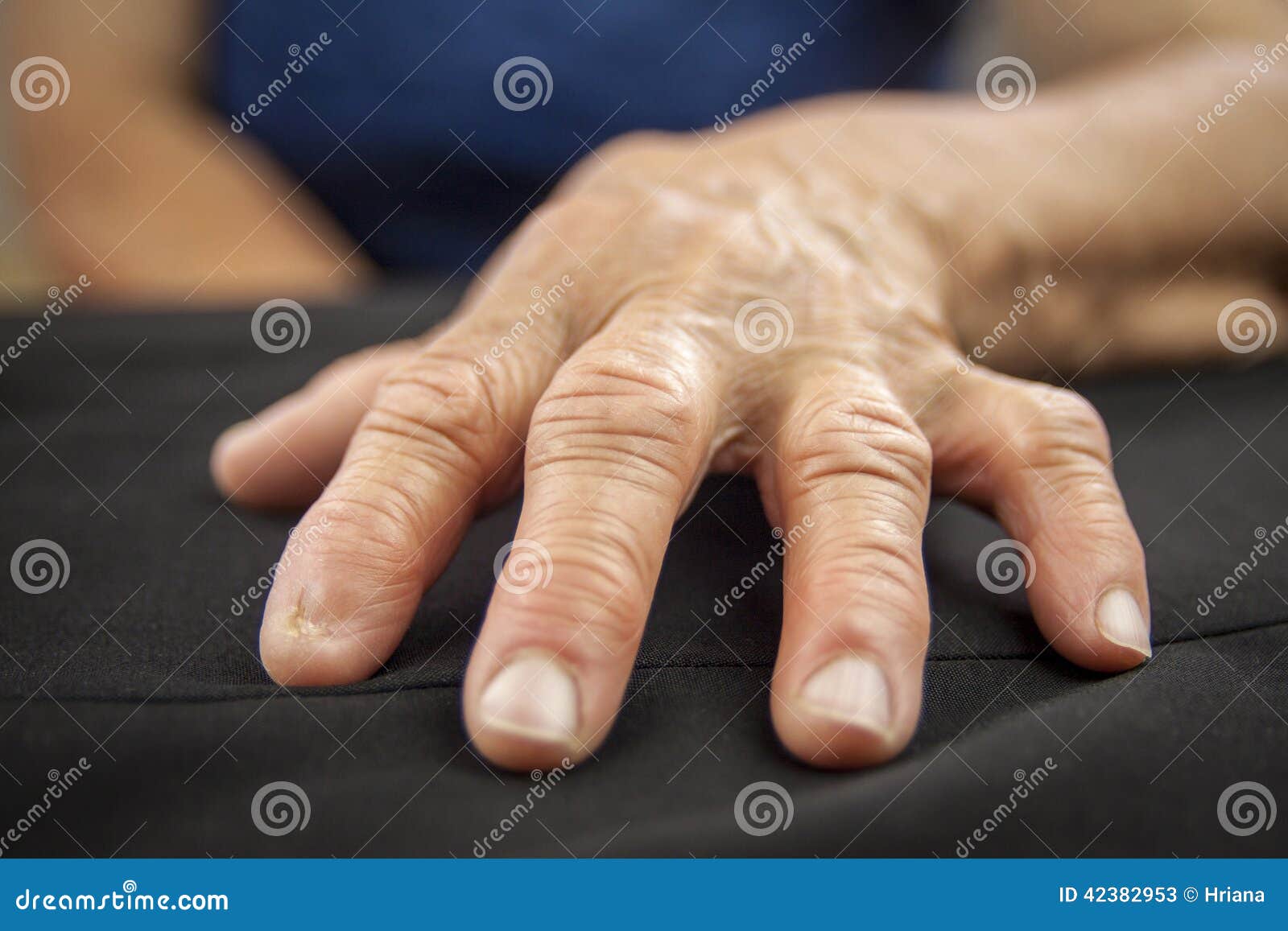 Main De Rhumatisme Articulaire Image stock - Image du diagnostic ...