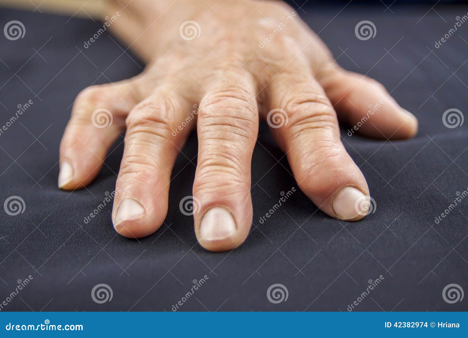 Main De Rhumatisme Articulaire Photo stock - Image du mains, diagnostic ...
