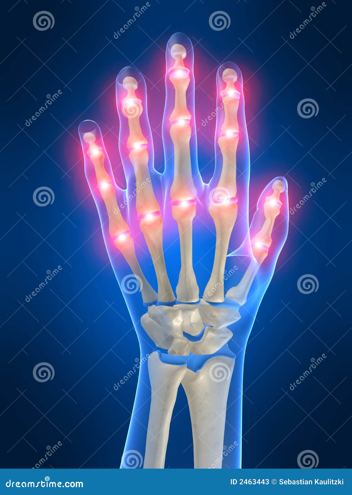 Main douloureuse illustration stock. Illustration du illustration - 2463443