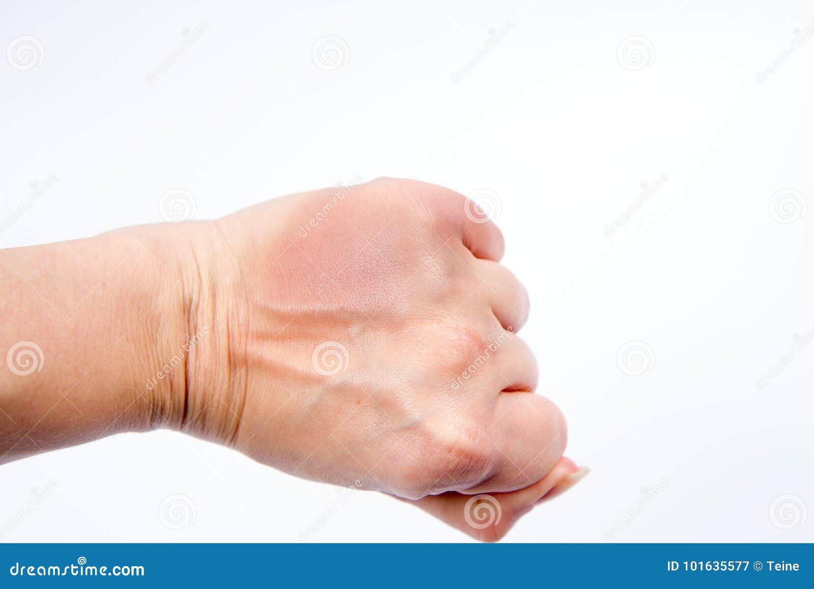 Main meurtrie image stock. Image du main, blessure, battement - 101635577