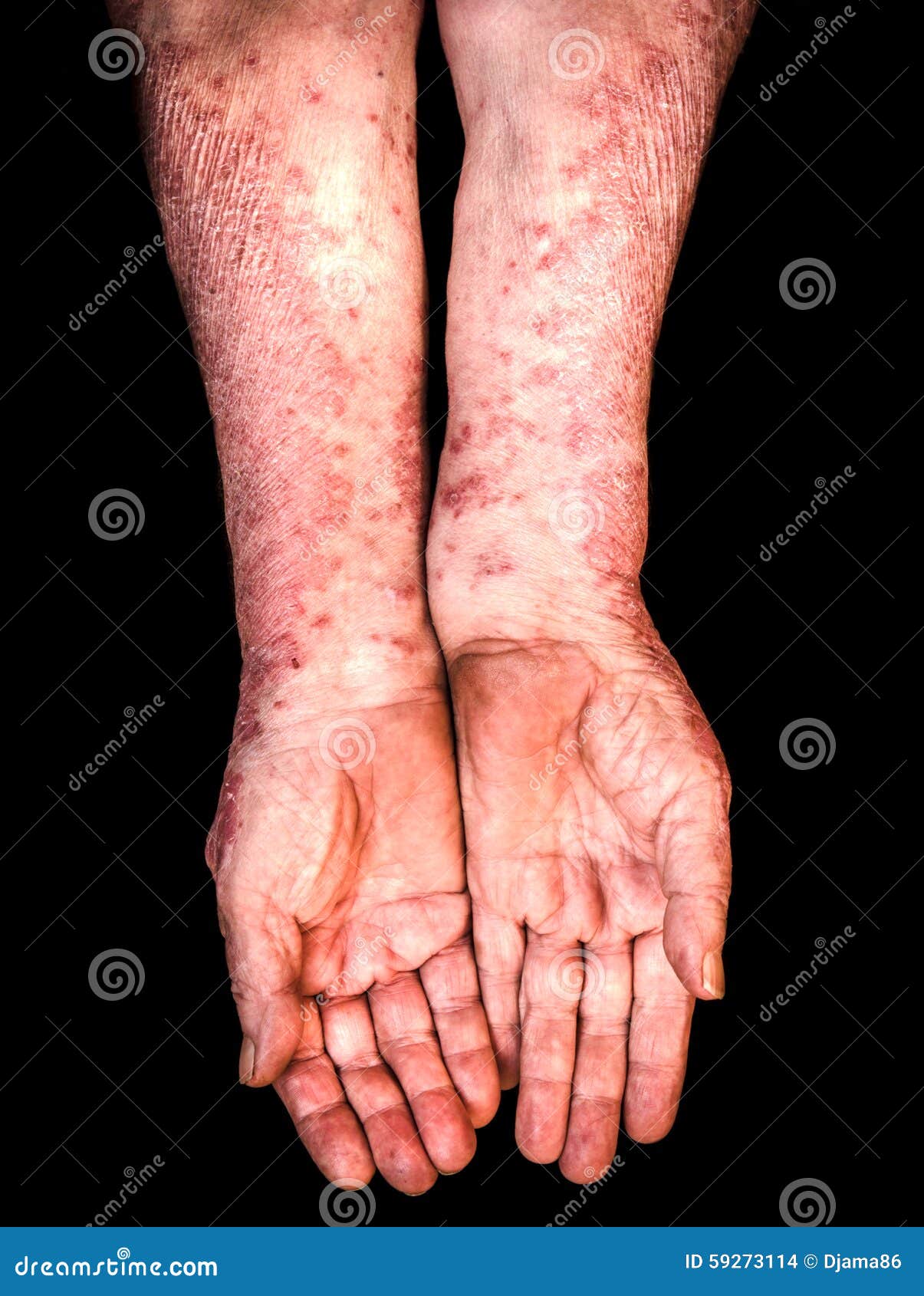 Mains avec le psoriasis photo stock. Image du allergie - 59273114