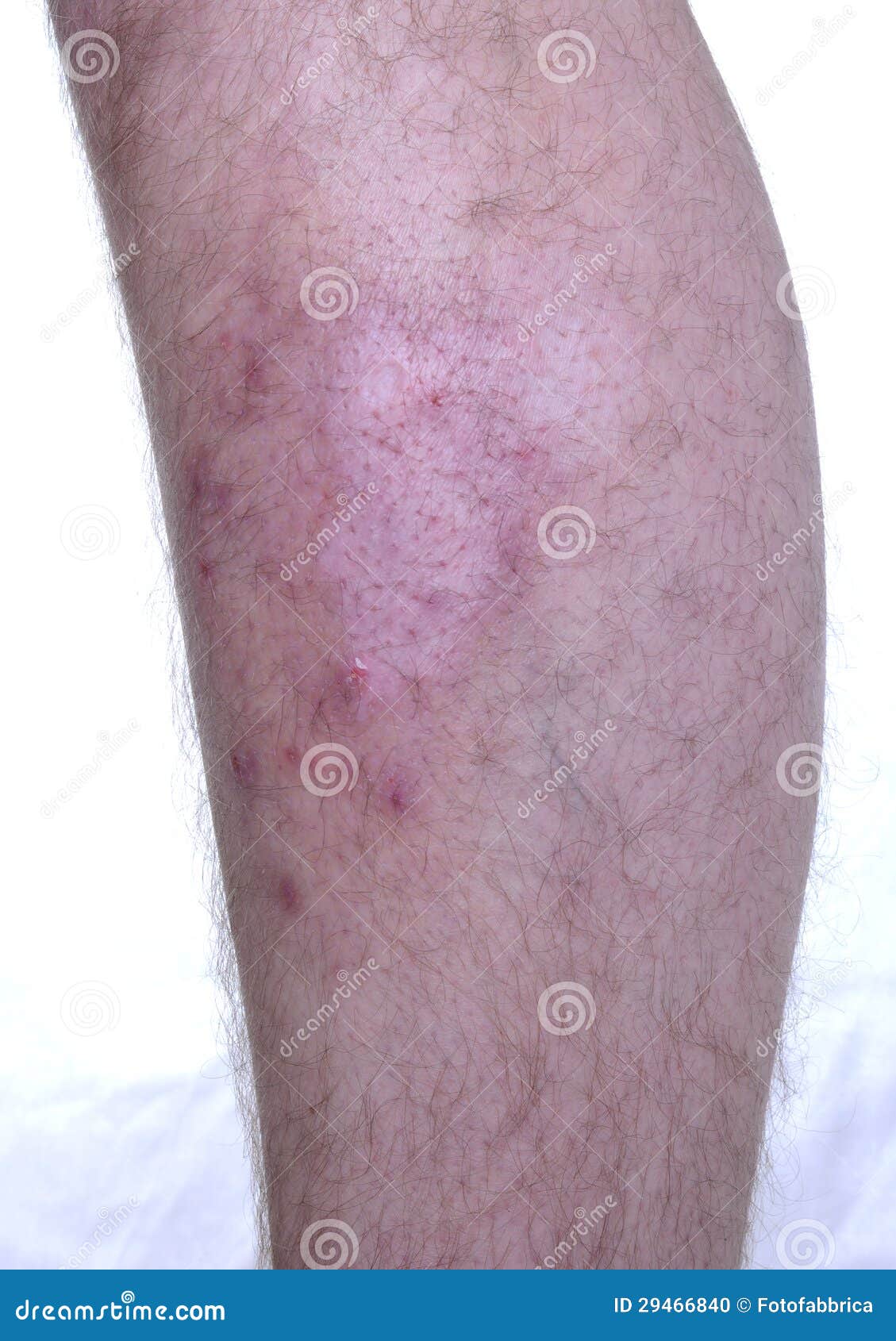 Maladie de la peau photo stock. Image du écaillement - 29466840