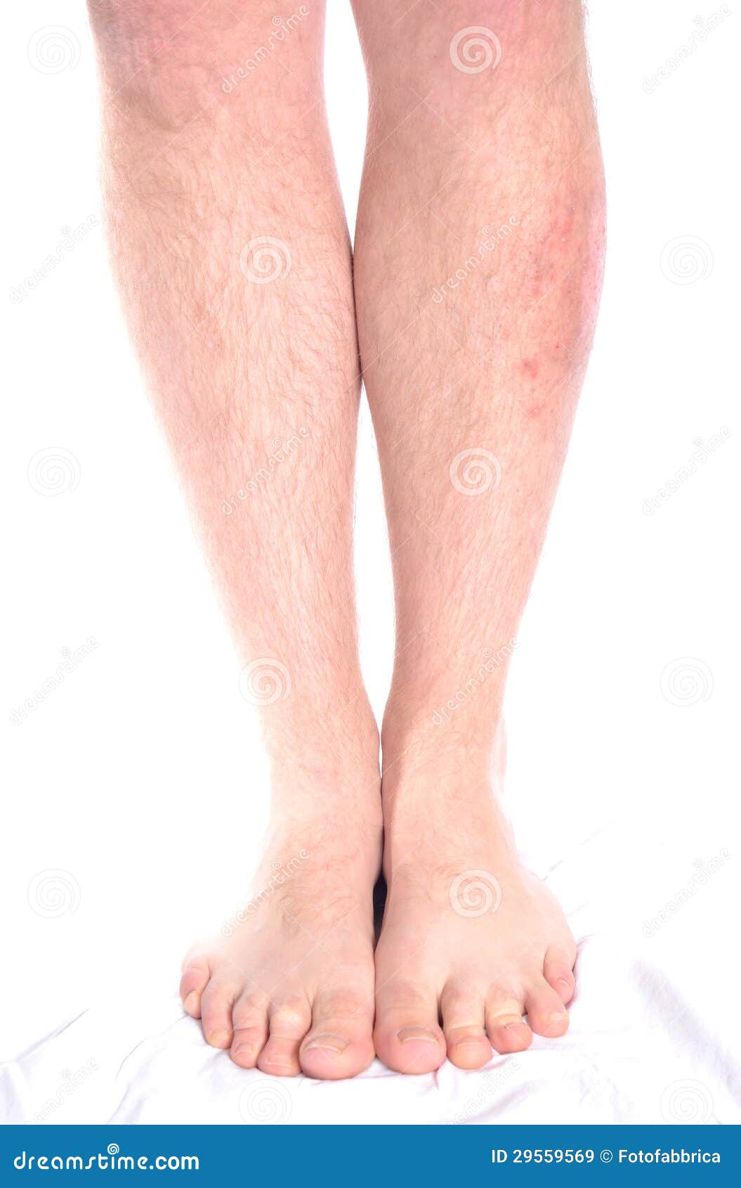 Maladie de la peau image stock. Image du éraflure, perte - 29559569