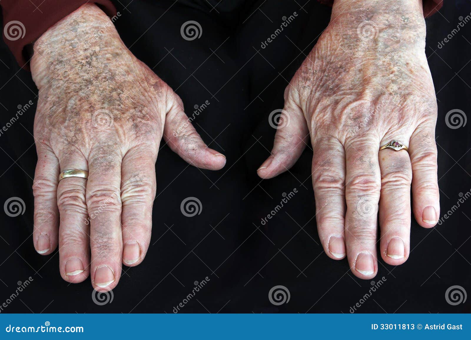 Maladie de la peau image stock. Image du older, maladie - 33011813