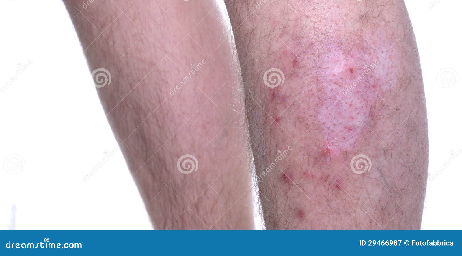 Maladie De La Peau Vitiligo Image stock - Image of humain, état: 29466987