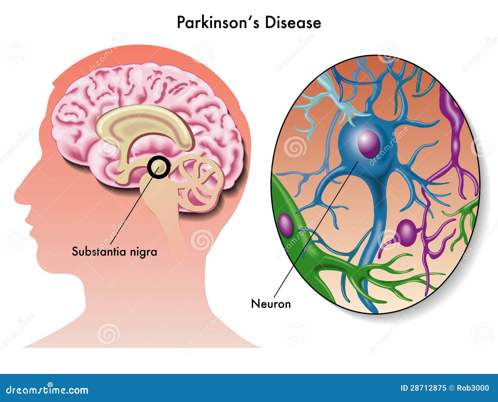 :maladie de Parkinson illustration de vecteur. Illustration du ...