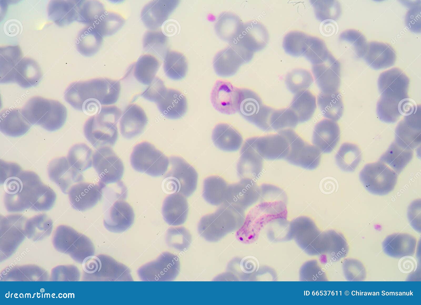 Malaria Globules Rouges Normales Et Infectées Photo stock - Image: 66537611