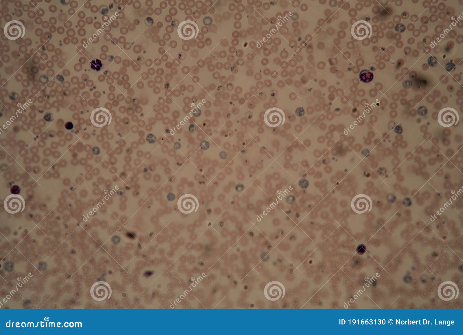 Malaria Parasites in Red Blood Cells 400x Stock Photo - Image of cells ...