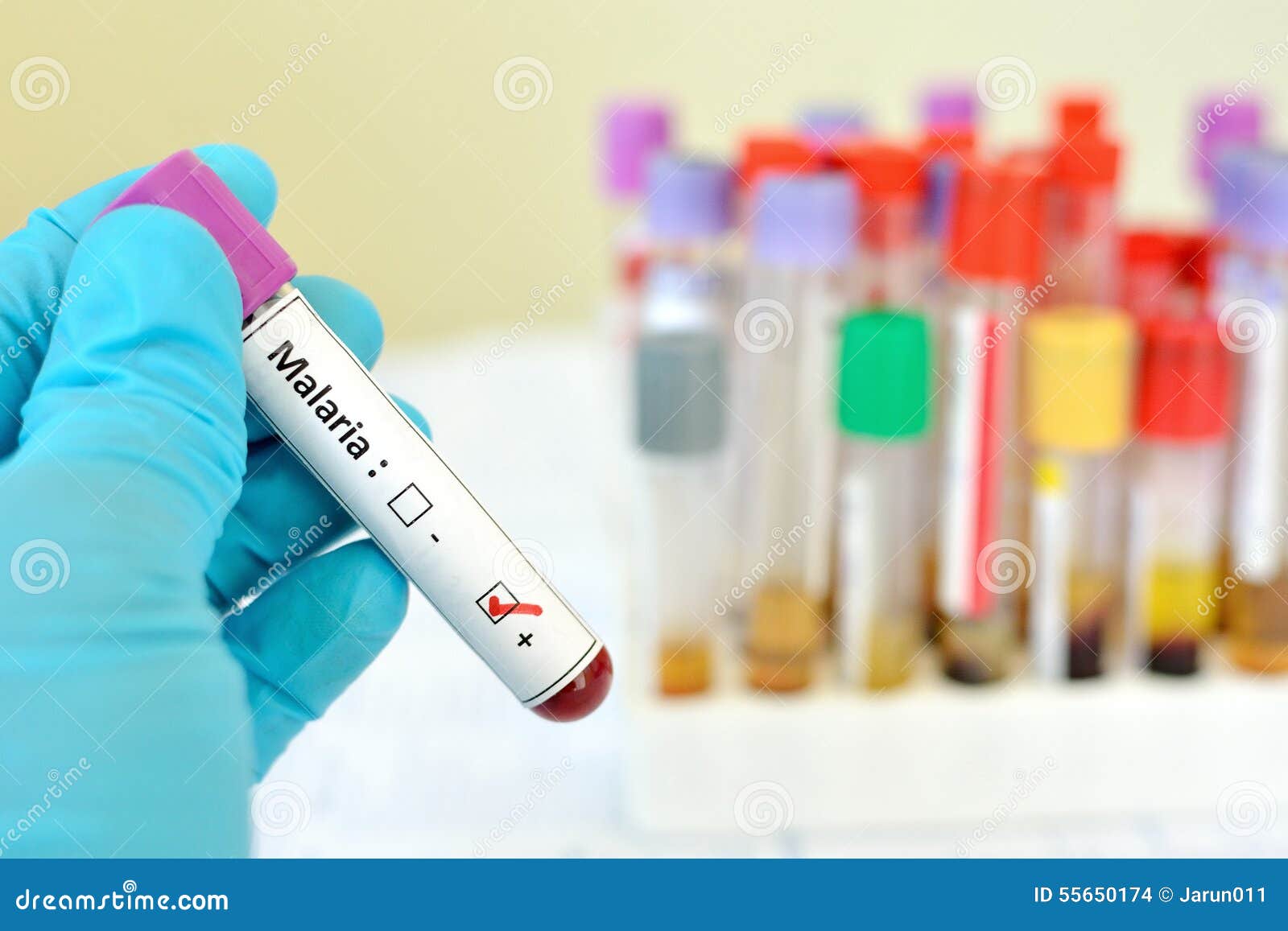 Malaria positive stock photo. Image of fever, patient - 55650174