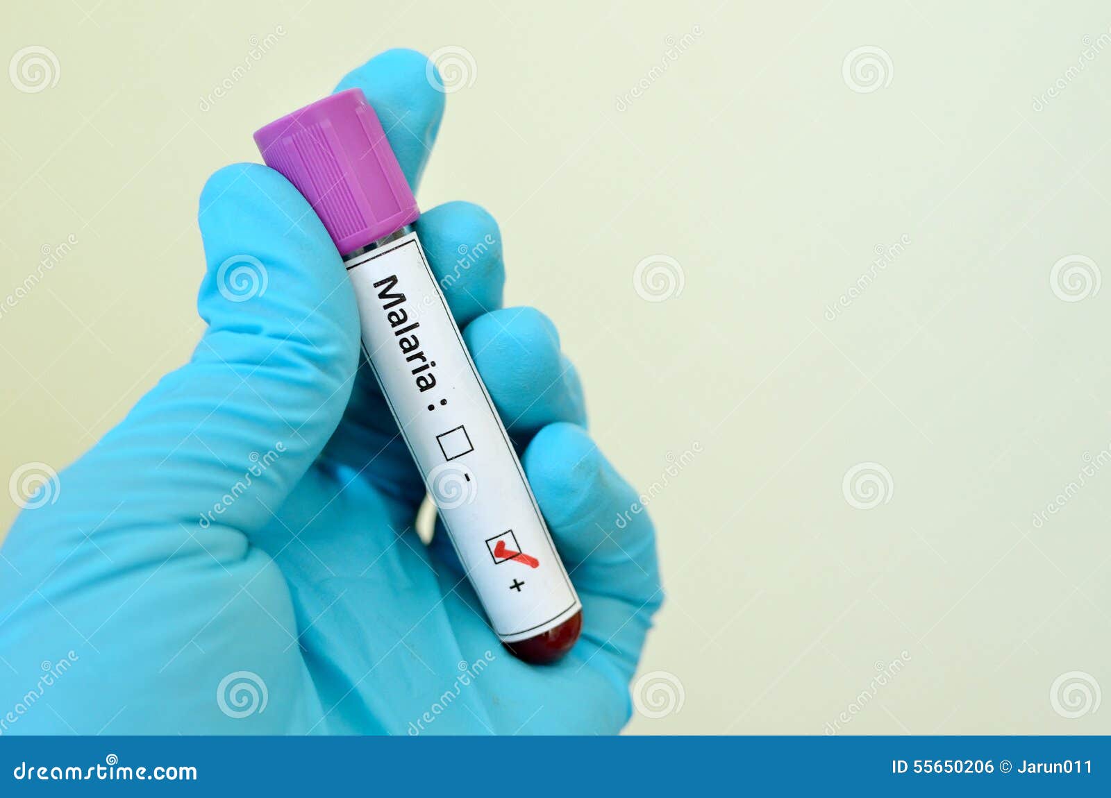 Malaria positive stock photo. Image of disease, illness - 55650206