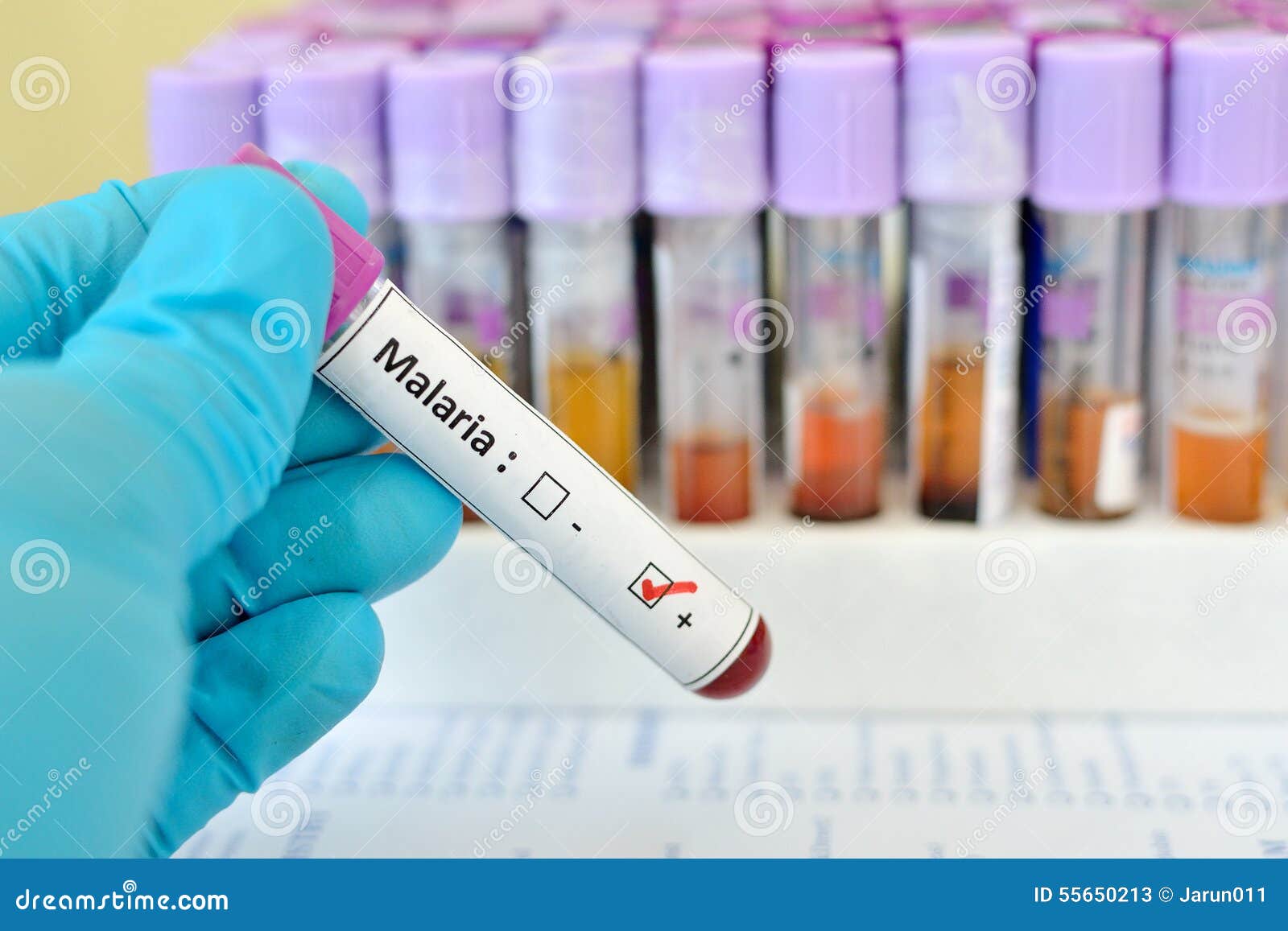 Malaria positive stock image. Image of hematology, fever - 55650213