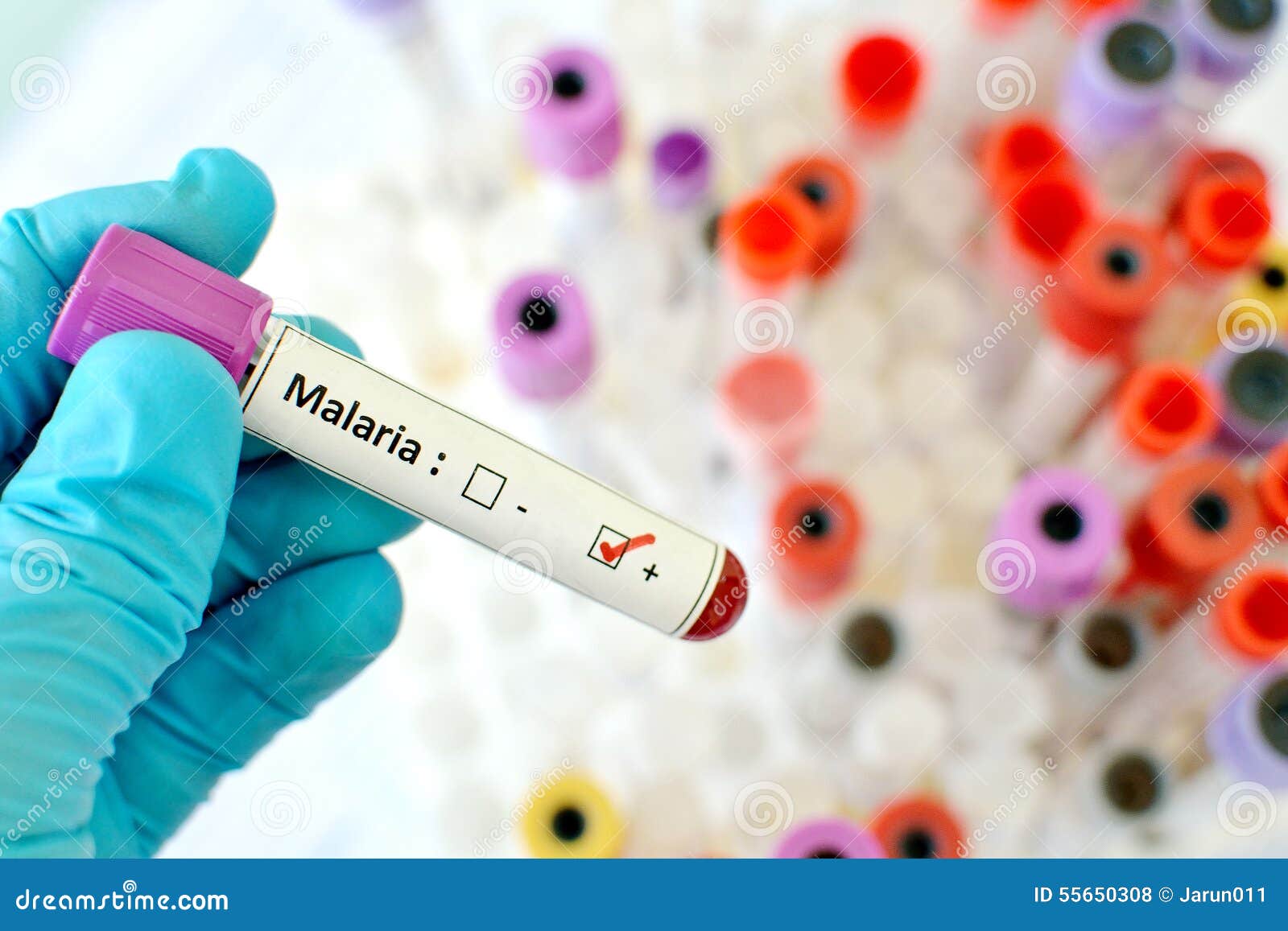 Malaria positive stock photo. Image of fever, science - 55650308