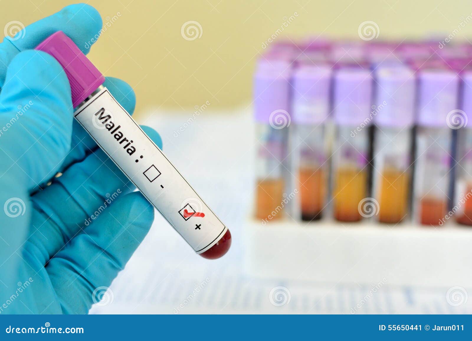 Malaria positive stock image. Image of plasmodium, analyzing - 55650441