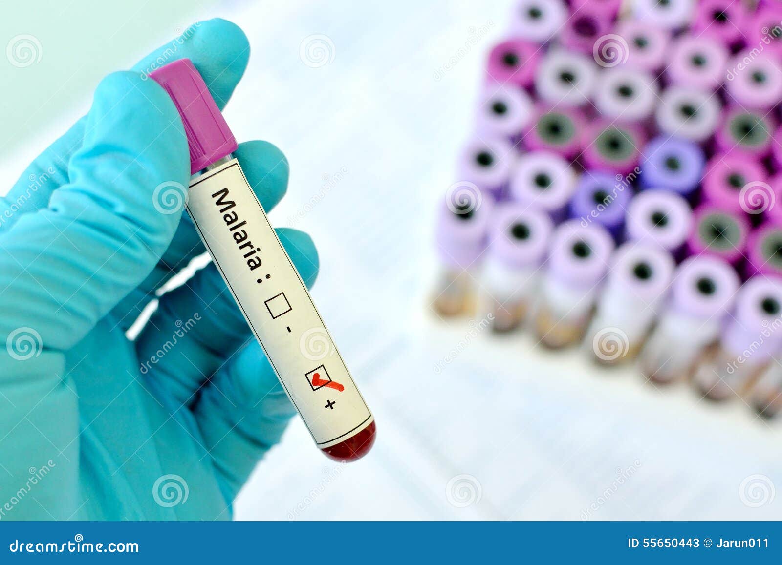 Malaria positive stock image. Image of immunology, patient - 55650443
