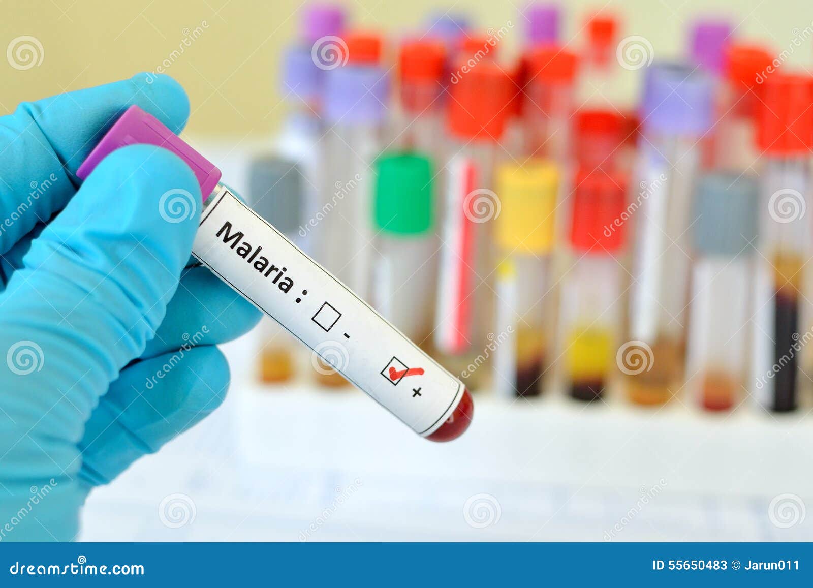 Malaria positive stock image. Image of medical, hematology - 55650483