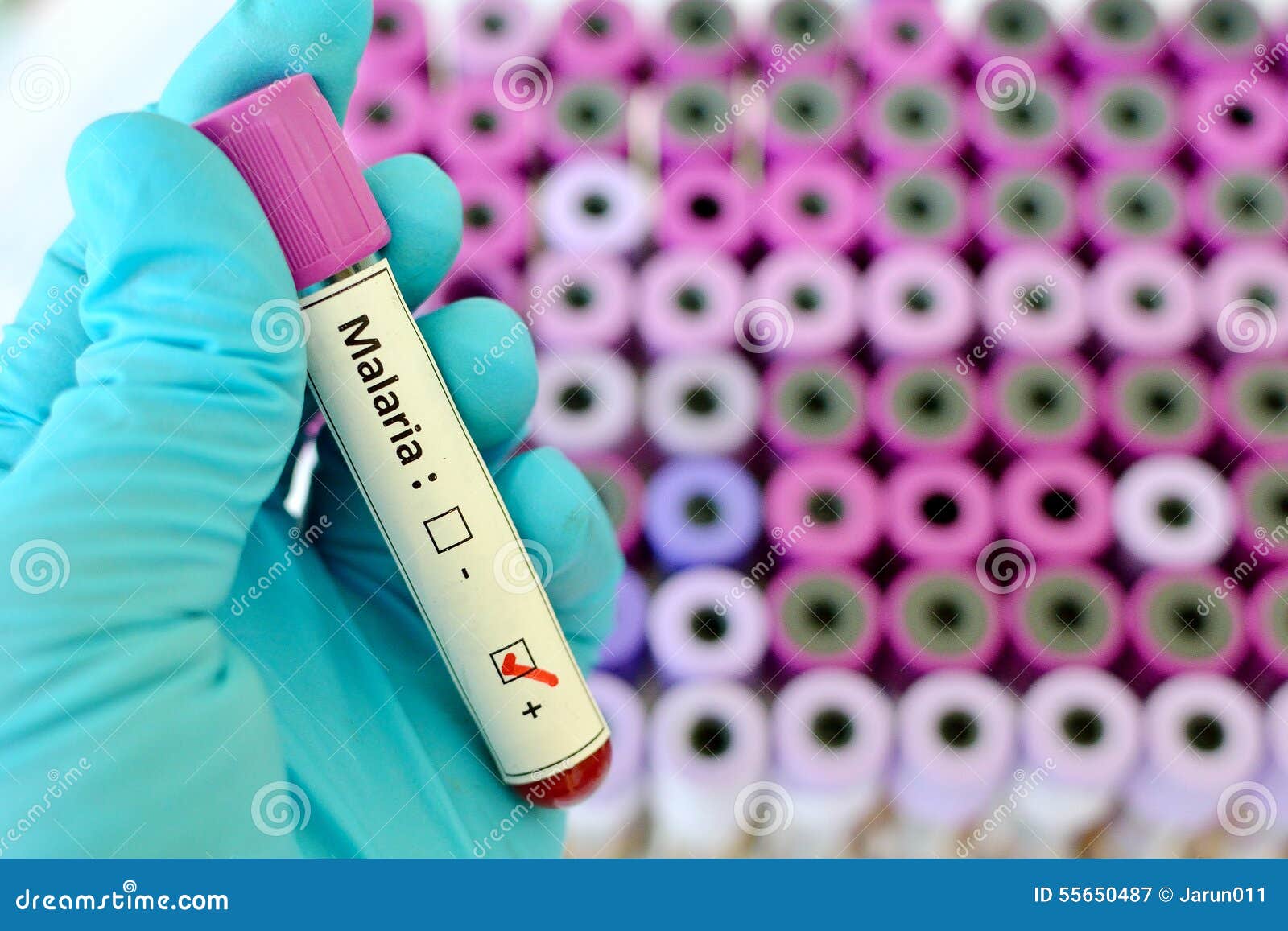 Malaria positive stock image. Image of disease, parasite - 55650487