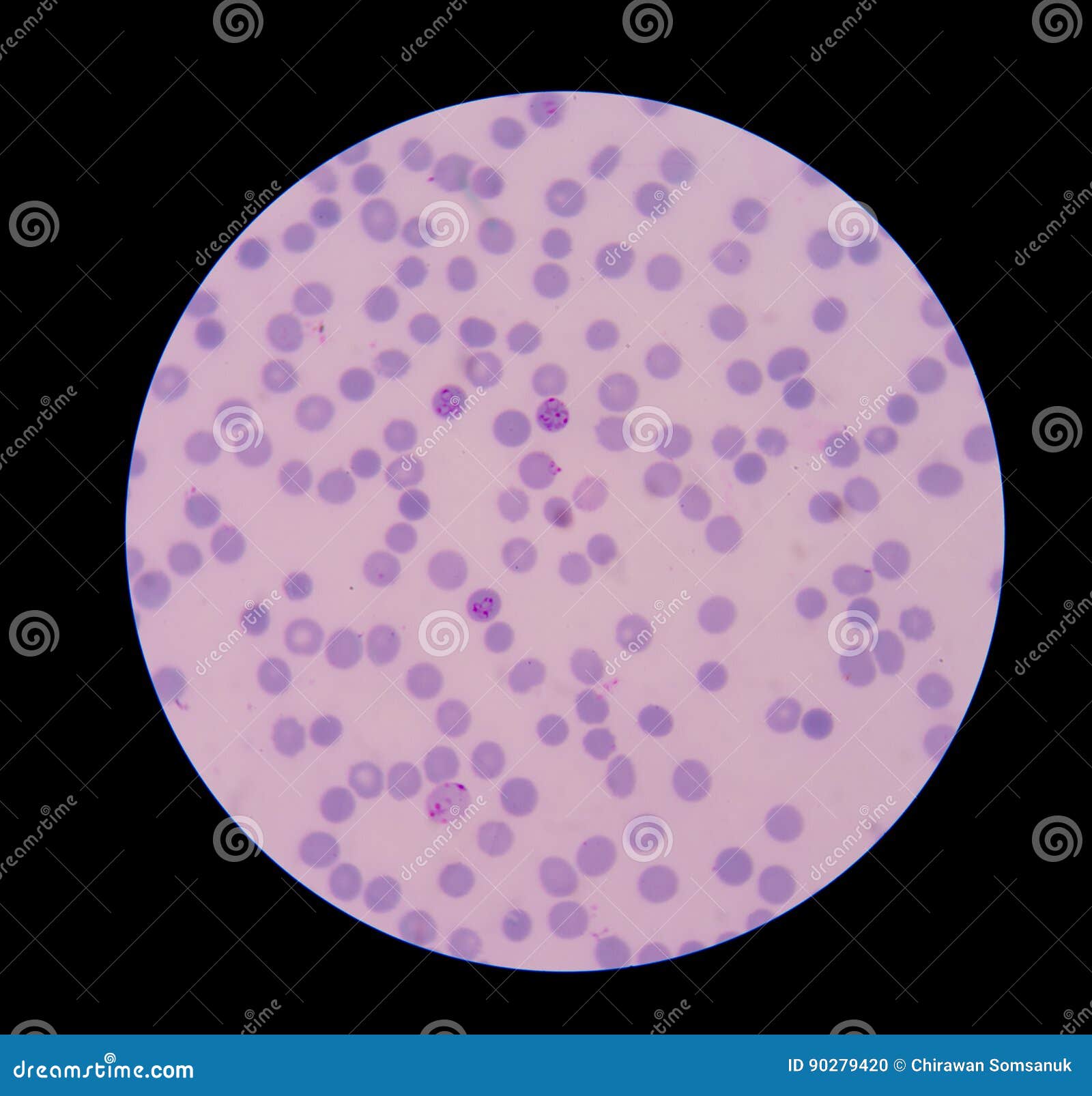 Ring Form Malaria Blood Parasite Infected Red Blood Cells Royalty-Free ...